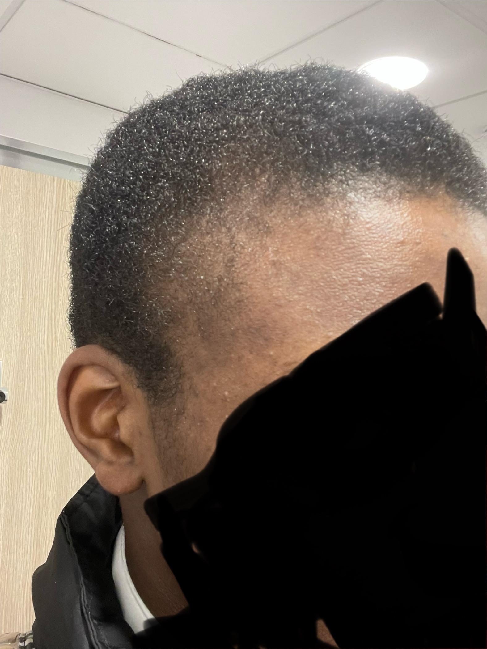 Is this normal for my hairline at 15? | Scrolller
