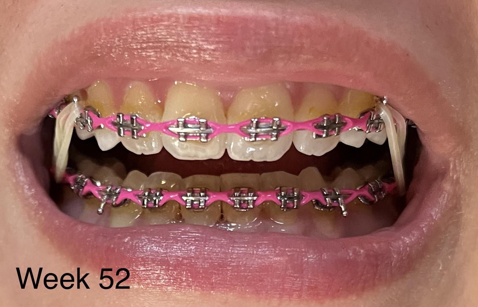 Happy first anniversary to my braces! | Scrolller