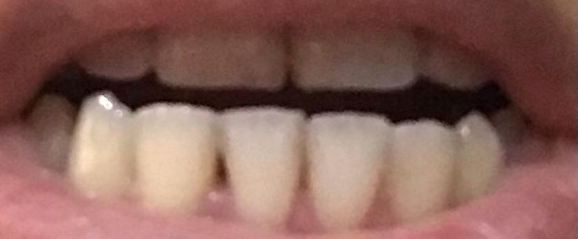 Tooth reshaping before and after! | Scrolller