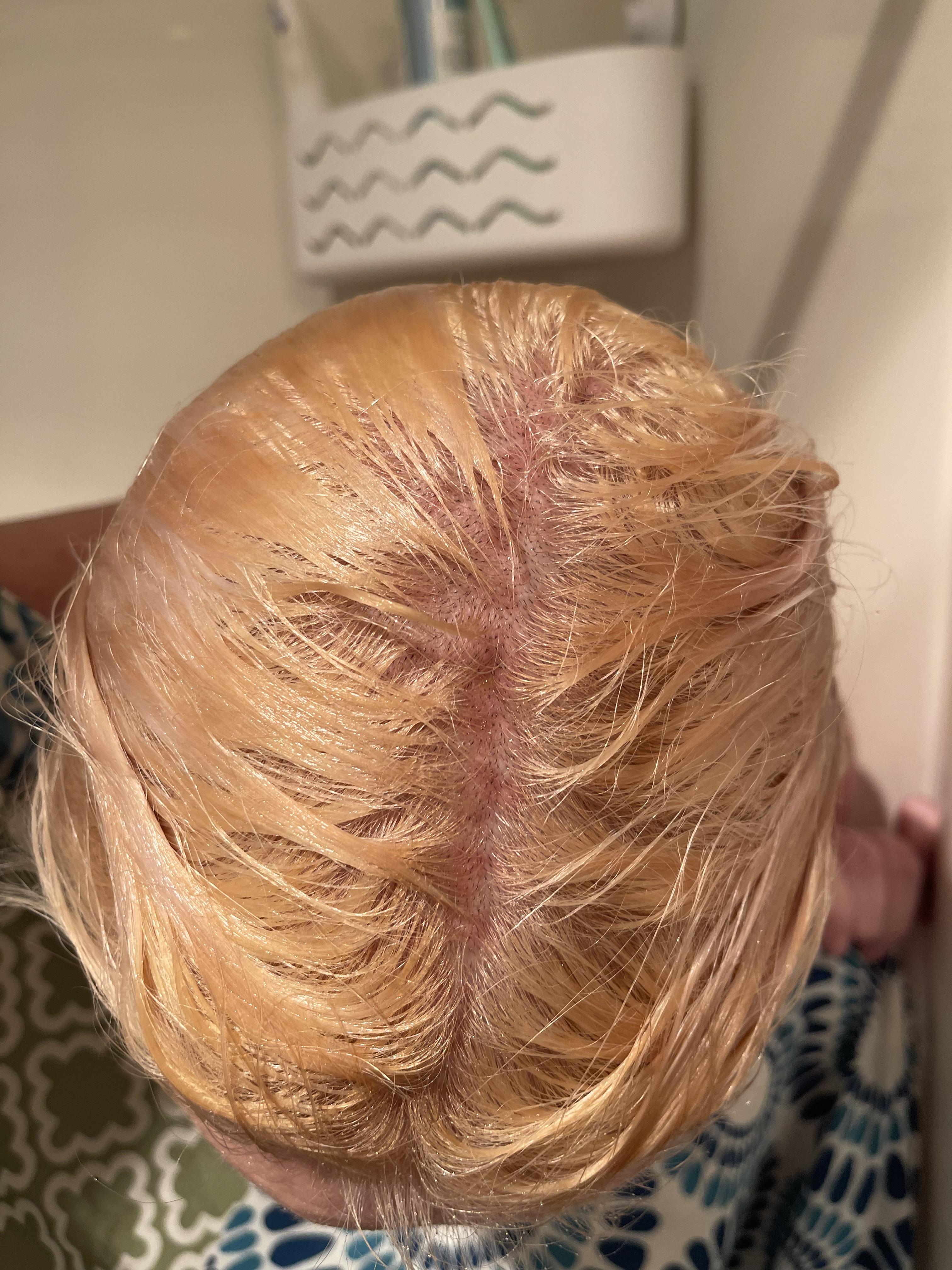 Bleach burn | Scrolller