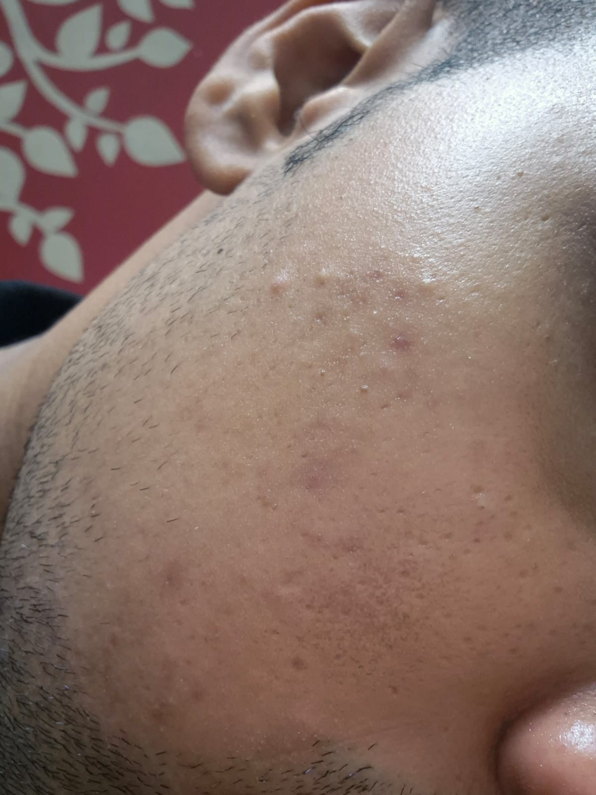 Bumps and dark spot on skin | Scrolller