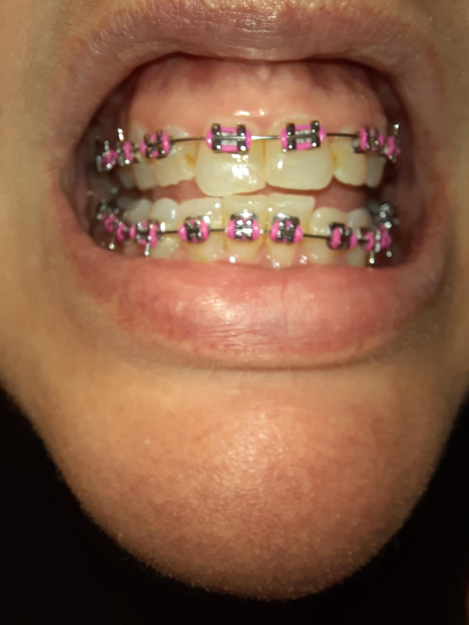 New wires and added brackets= PAIN | Scrolller