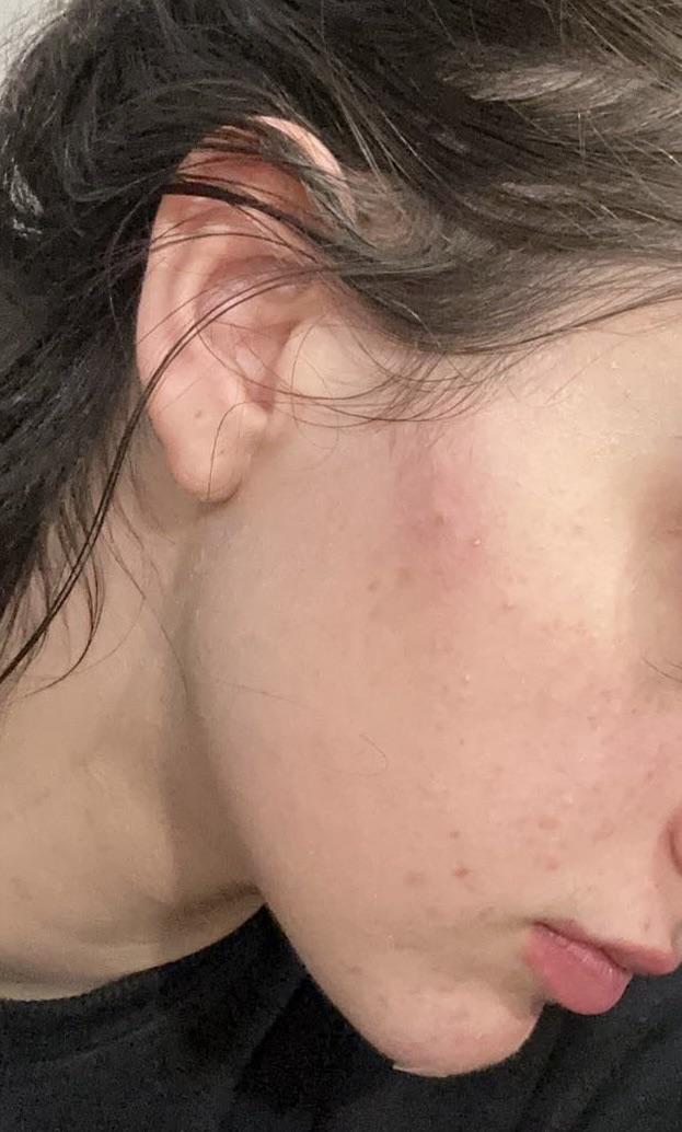 How do I know if my moisturiser is clogging my pores? | Scrolller