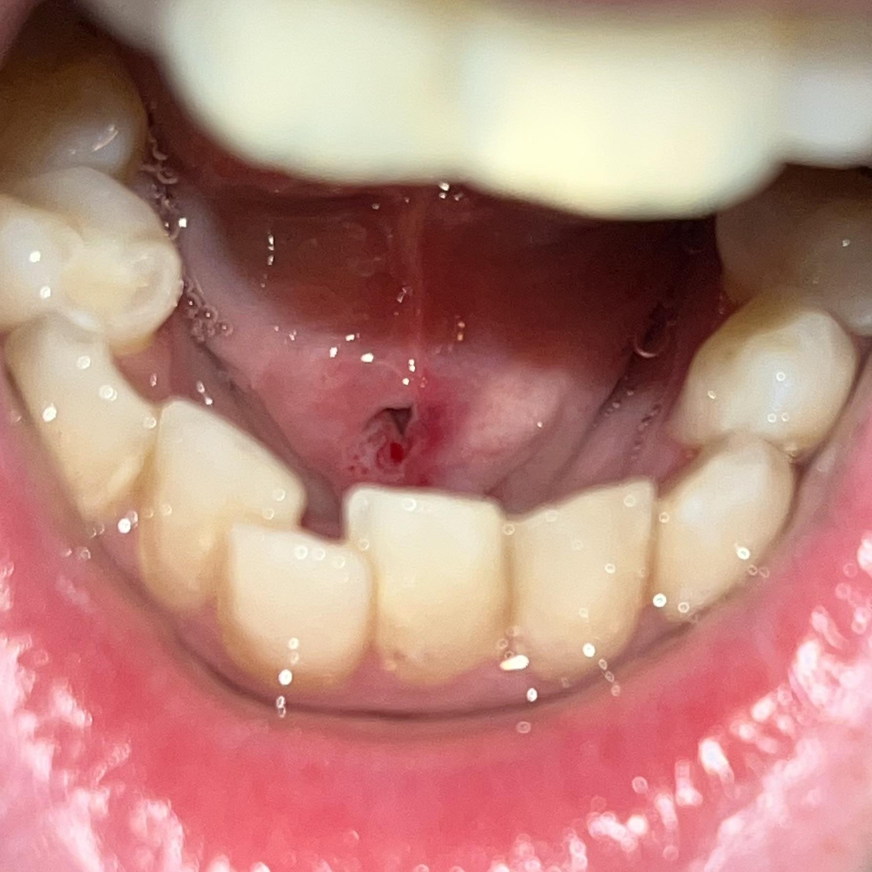 Dentist nicked under my tongue/floor of mouth with drill. | Scrolller