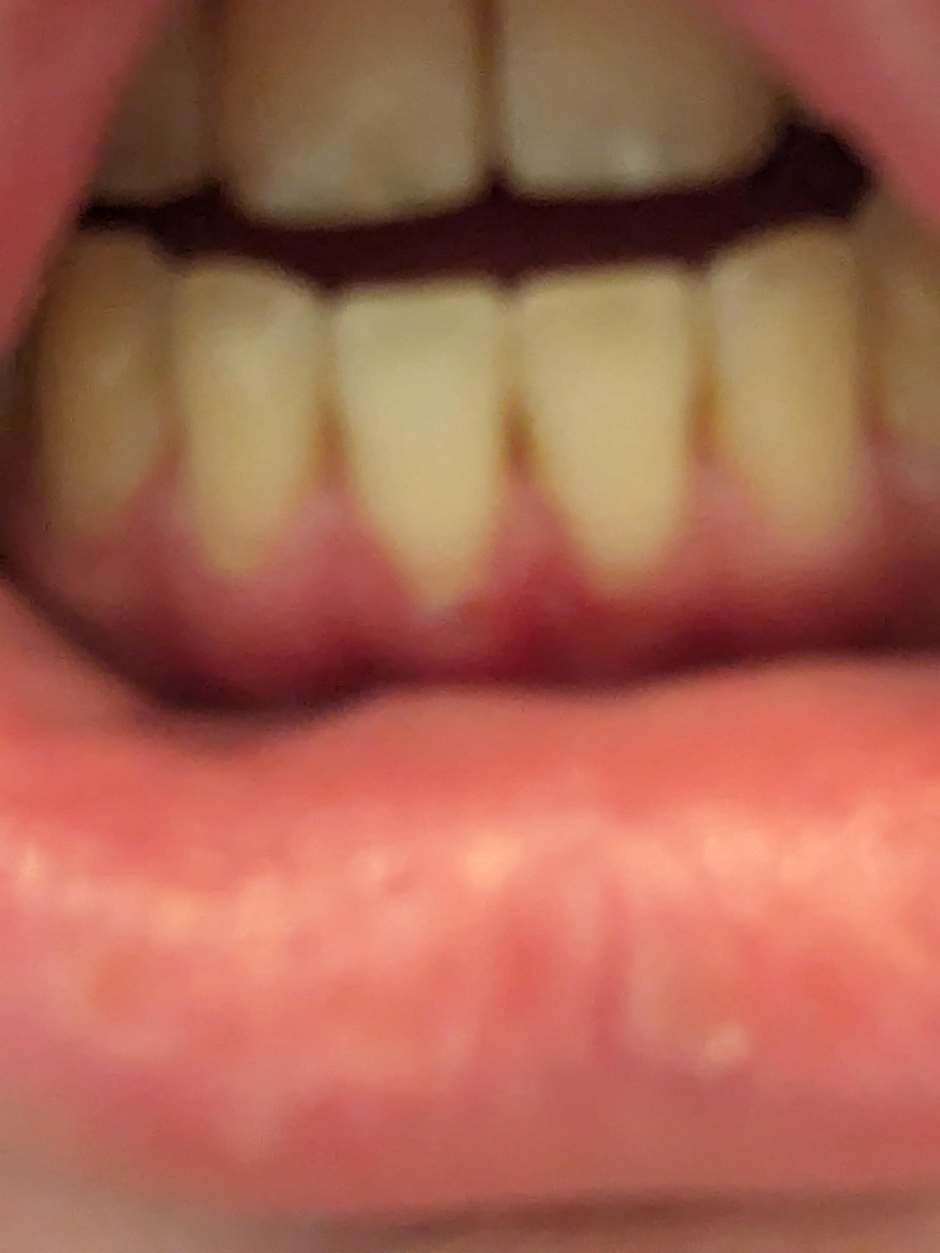 There's a gap in my gums that's showing the root of my front tooth | Scrolller