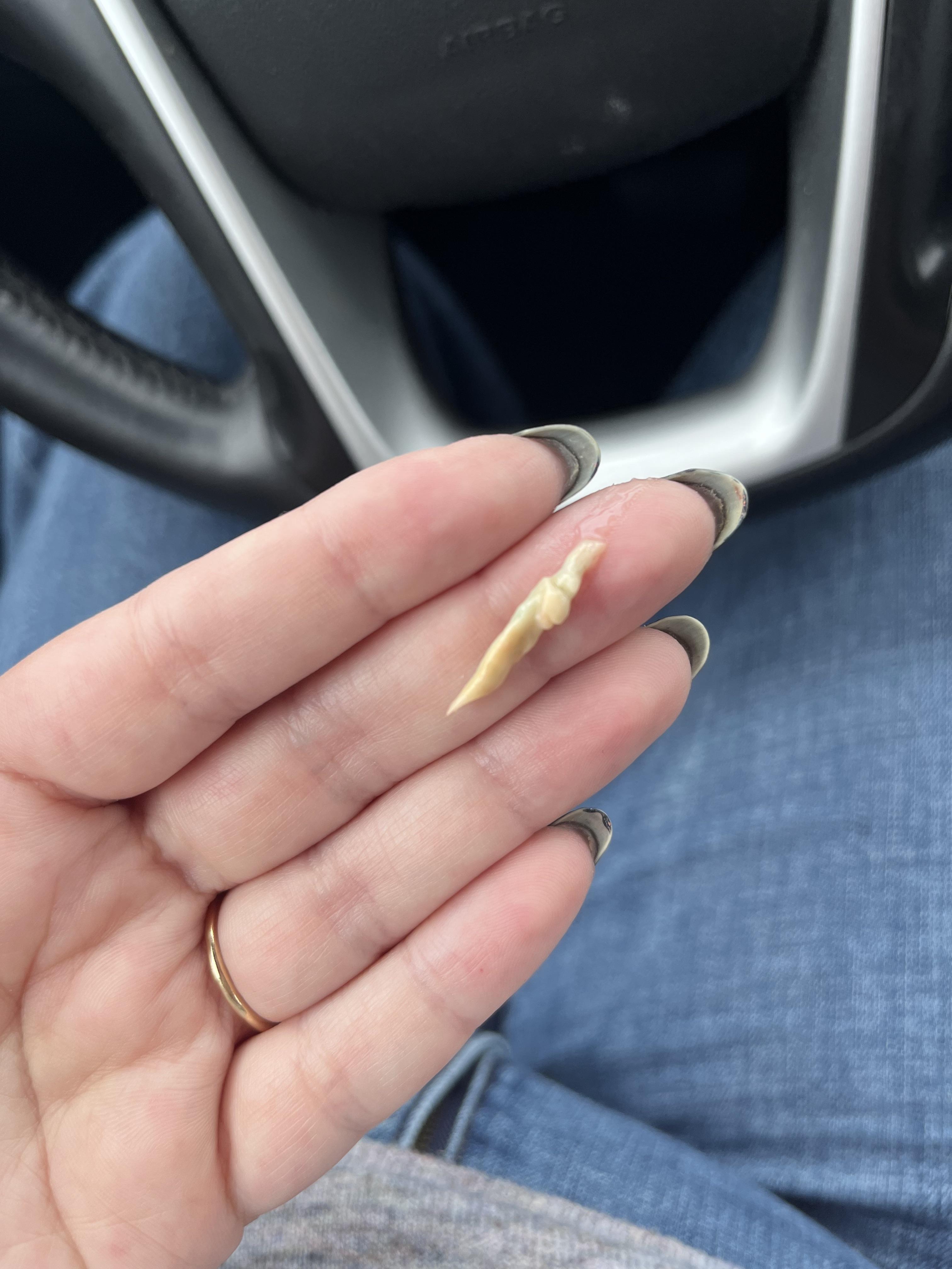 Tear duct stone (through sinus) | Scrolller