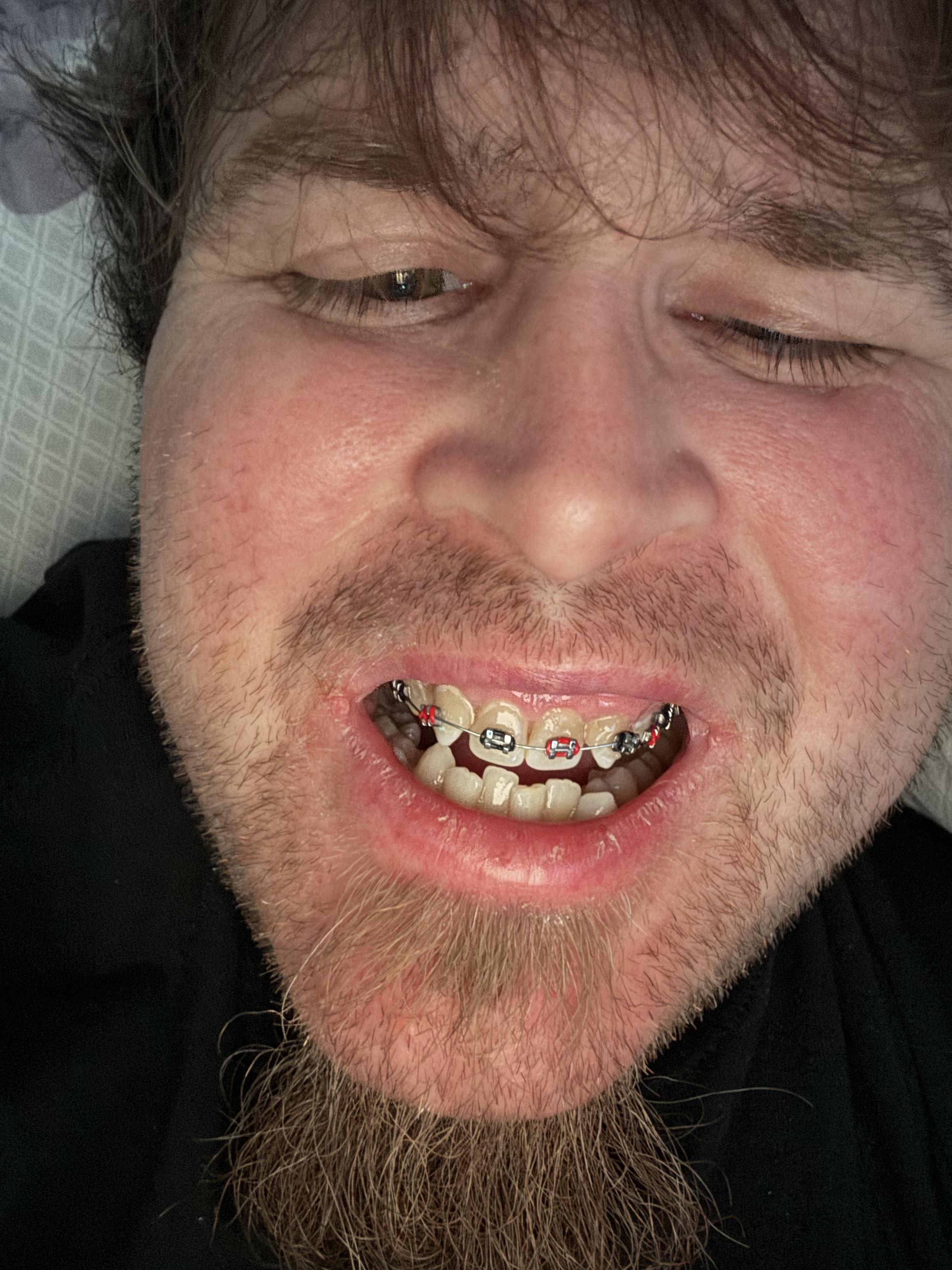 Discover More Like Braces 2 Weeks Of Braces And Still No Improvement Ugh How Long Til I See