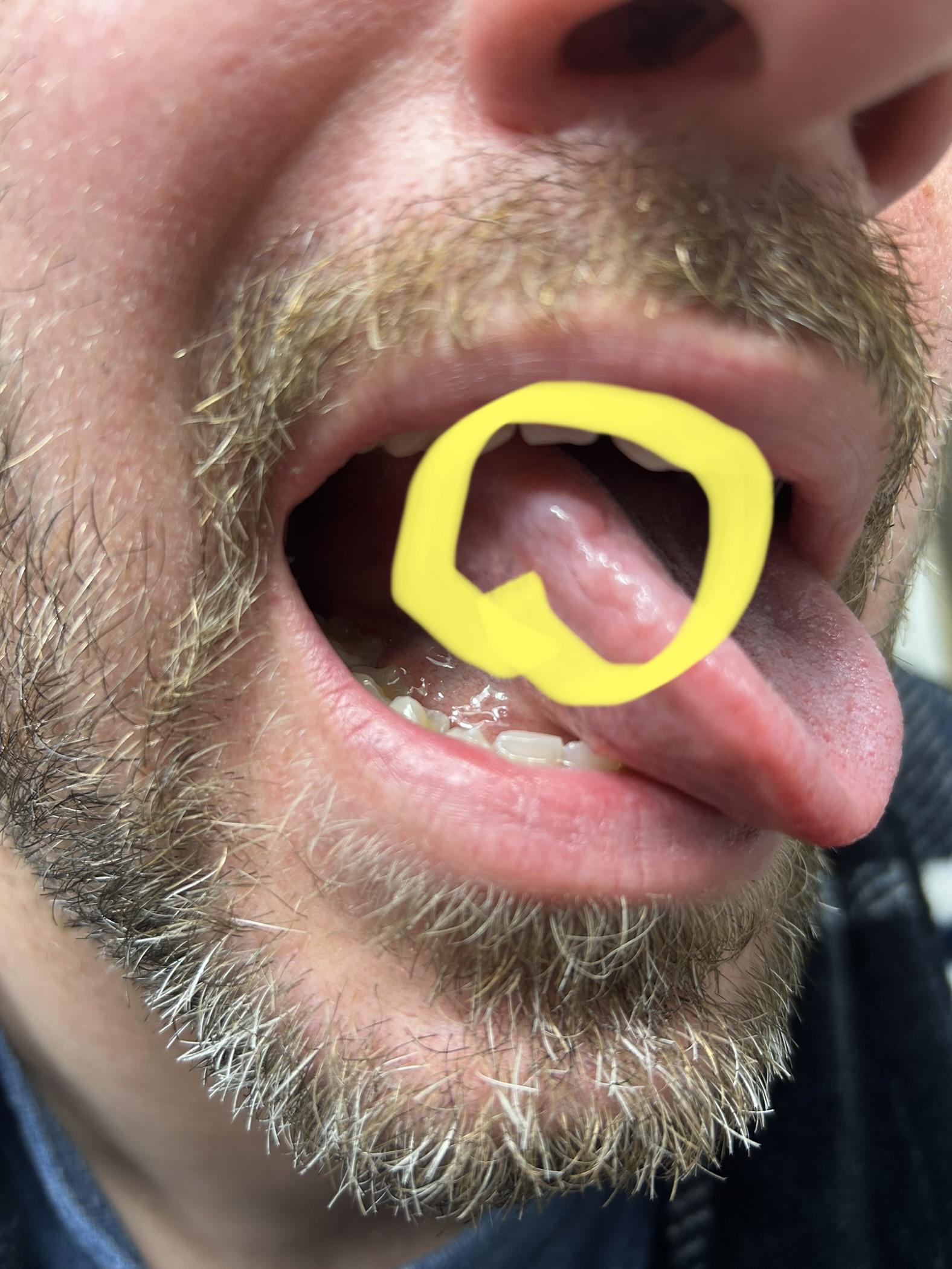 Bumps on tongue | Scrolller