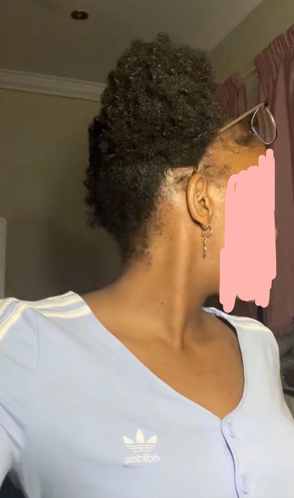 Permanent traction alopecia??? | Scrolller