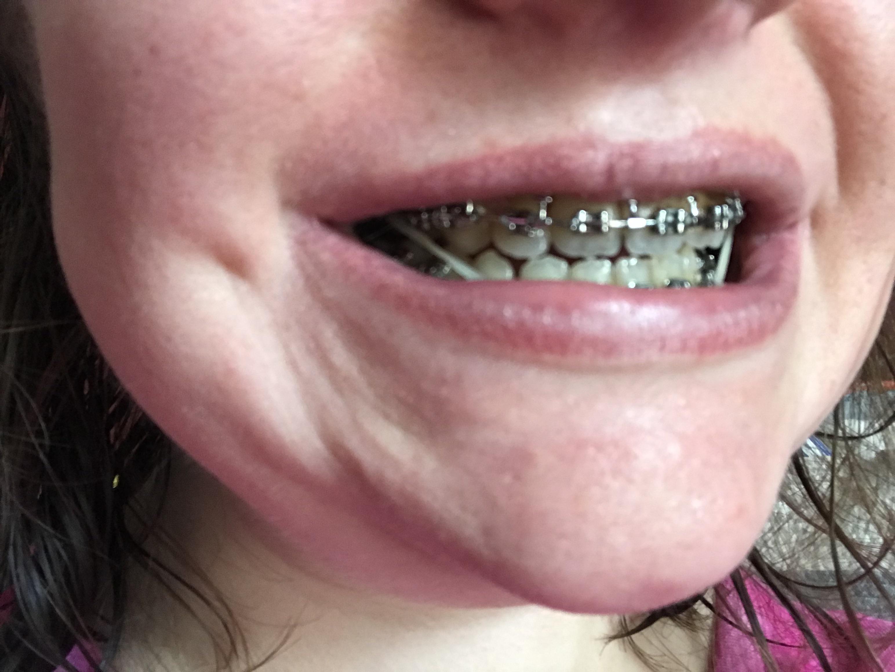 The difference elastics can make | Scrolller