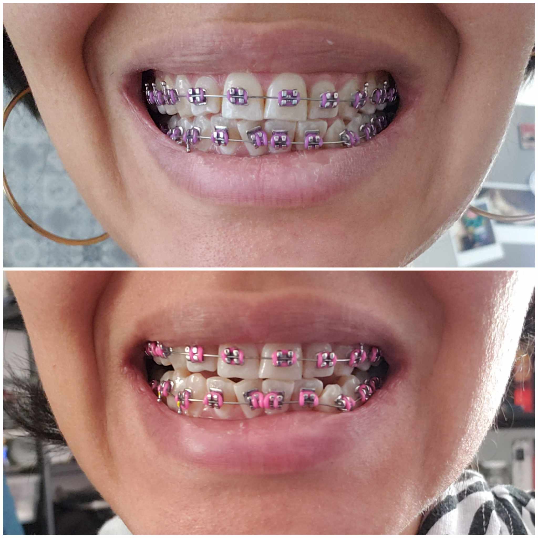 Opinions on extractions? Also, 4 months progress! | Scrolller
