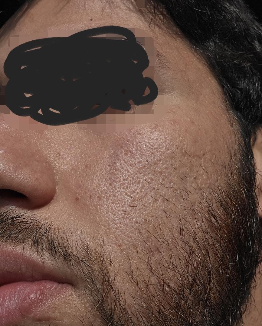 What is the cheapest and easiest way to get rid of my scars and improve my skin ? | Scrolller