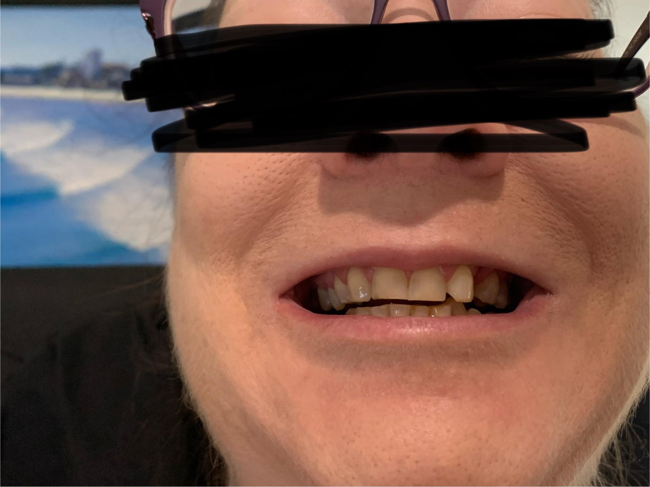 Staining on a front tooth | Scrolller