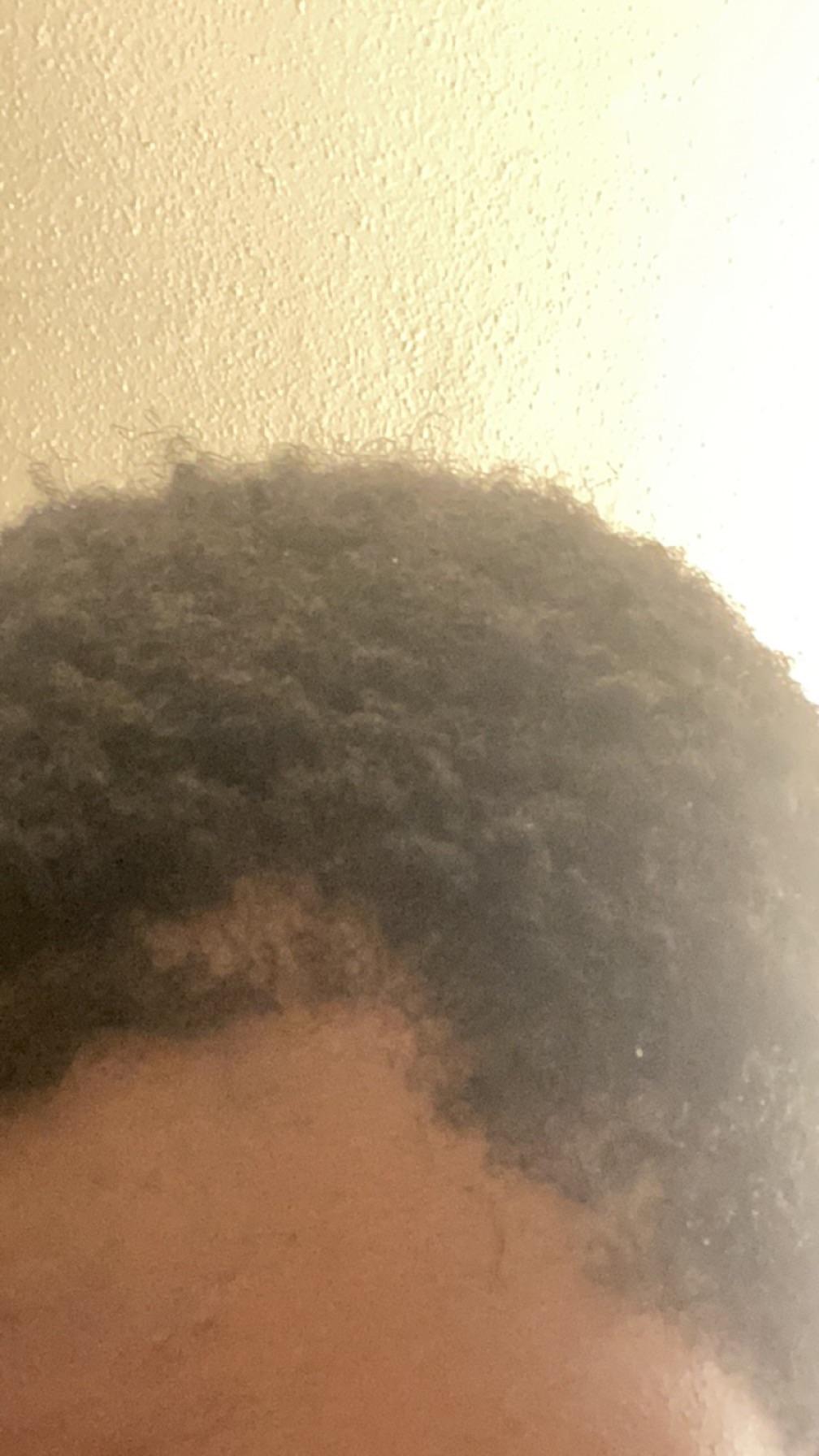 Big forehead and receding hairline | Scrolller