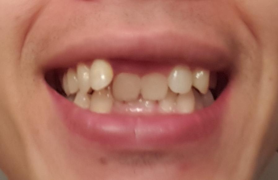Adult braces off after 4 years and 8 extractions. | Scrolller