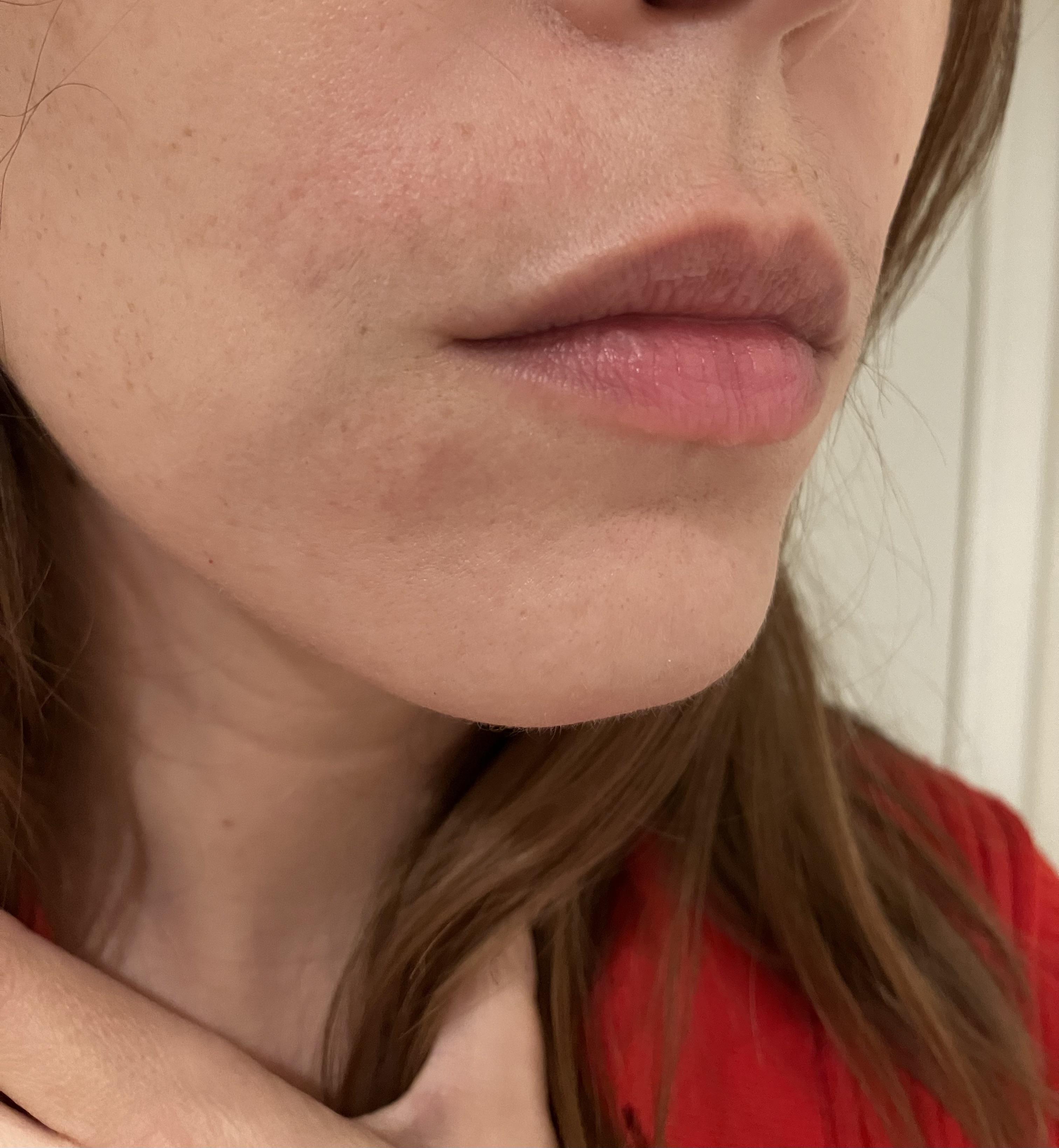 Perioral dermatitis redness! | Scrolller