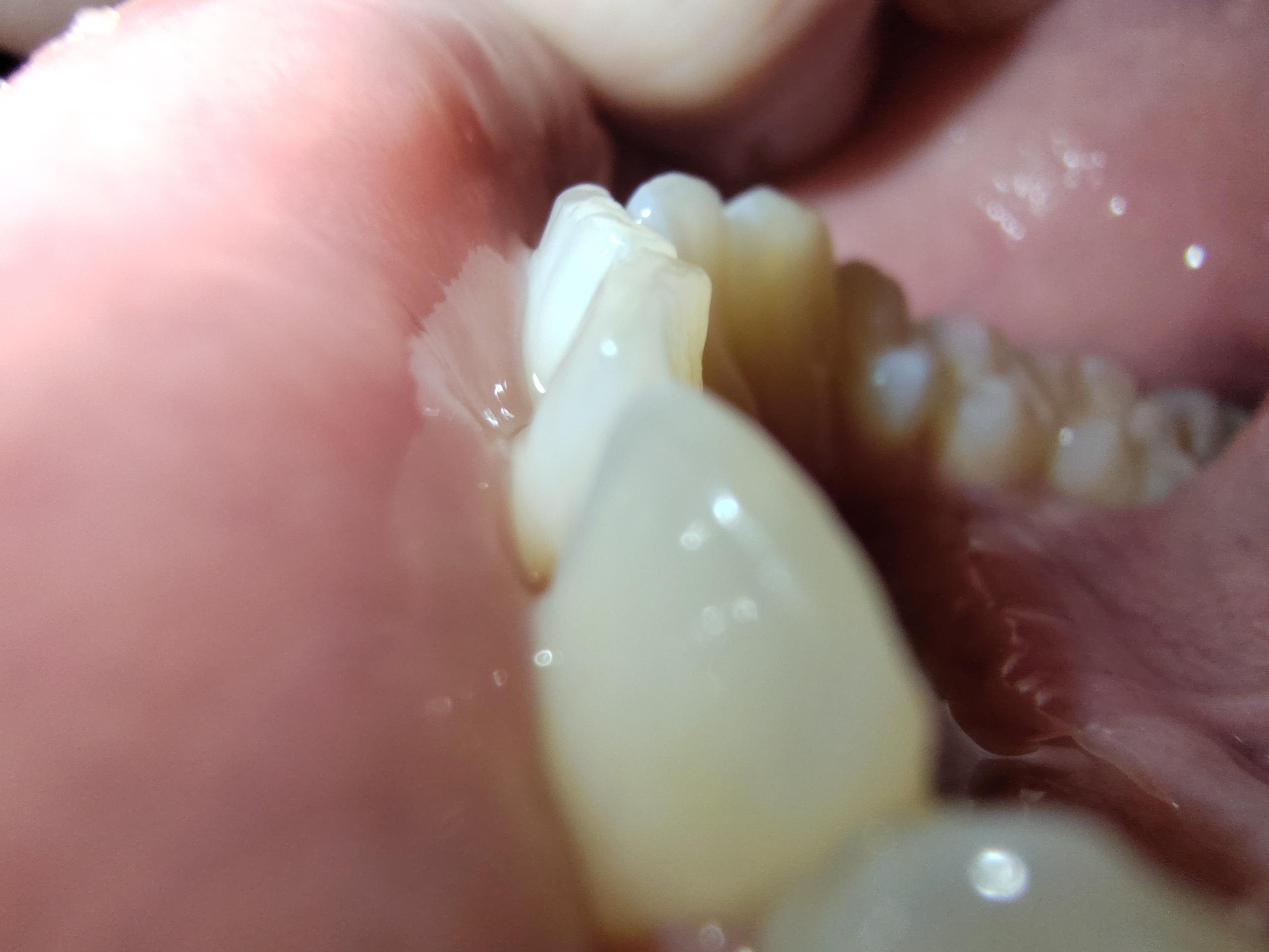 Awful pain around wisdom tooth for a year now dental insurance help me figure out what to do ...