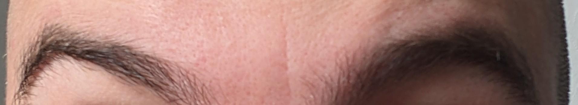 Help! How do I get rid of that wrinkle between my eyebrows? | Scrolller