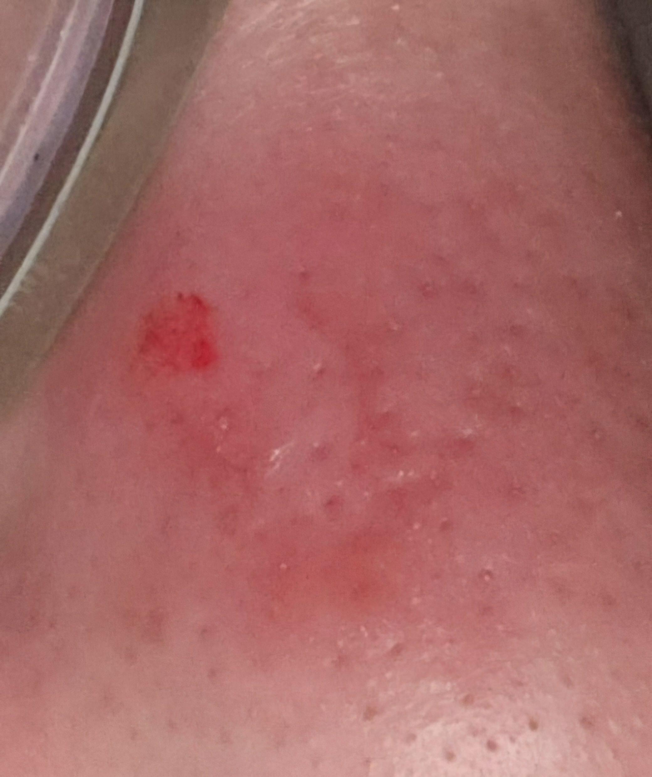 I got a bump on my nose. | Scrolller