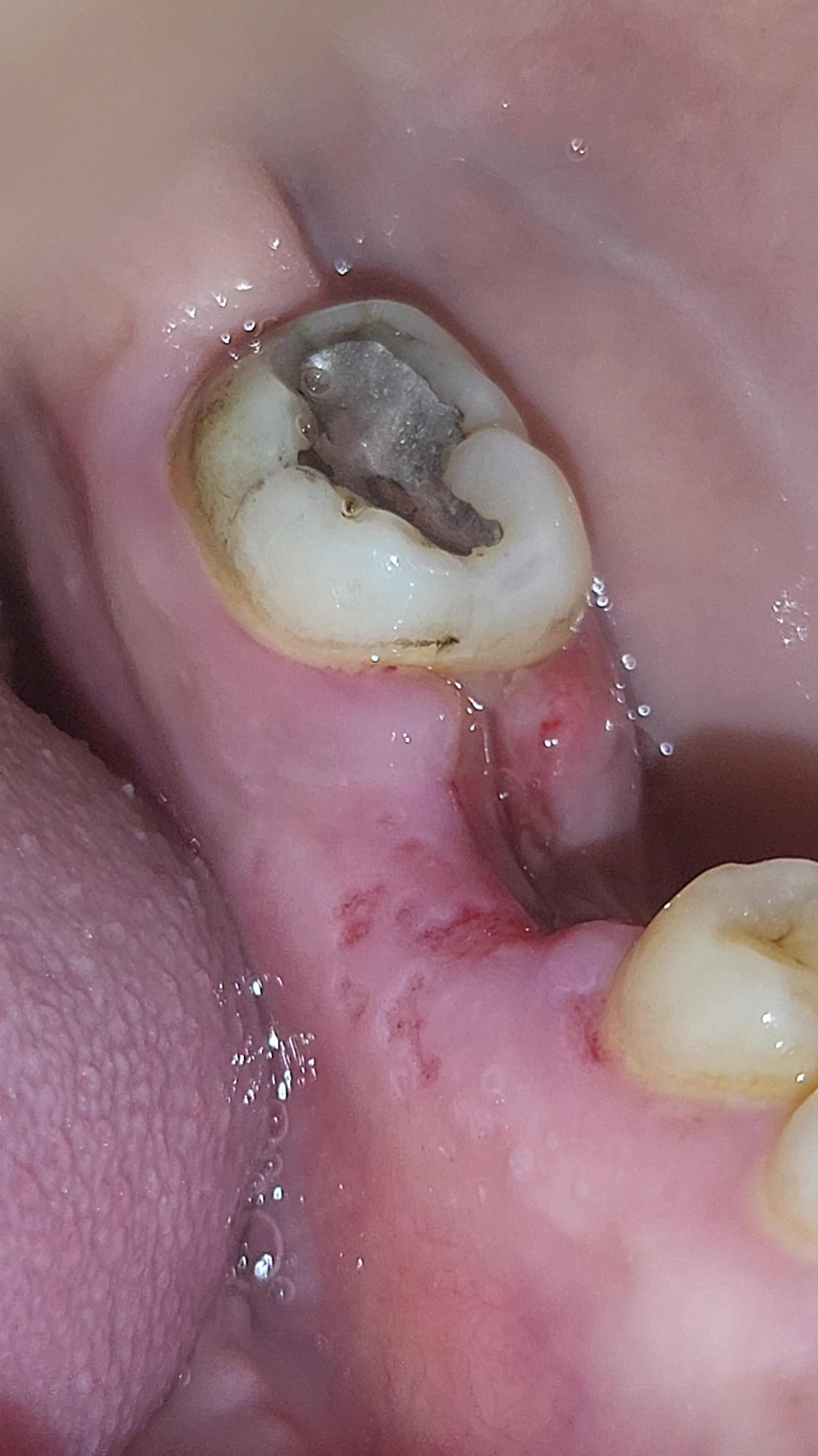 Just got a tooth extraction. Is this herpes or trauma? | Scrolller