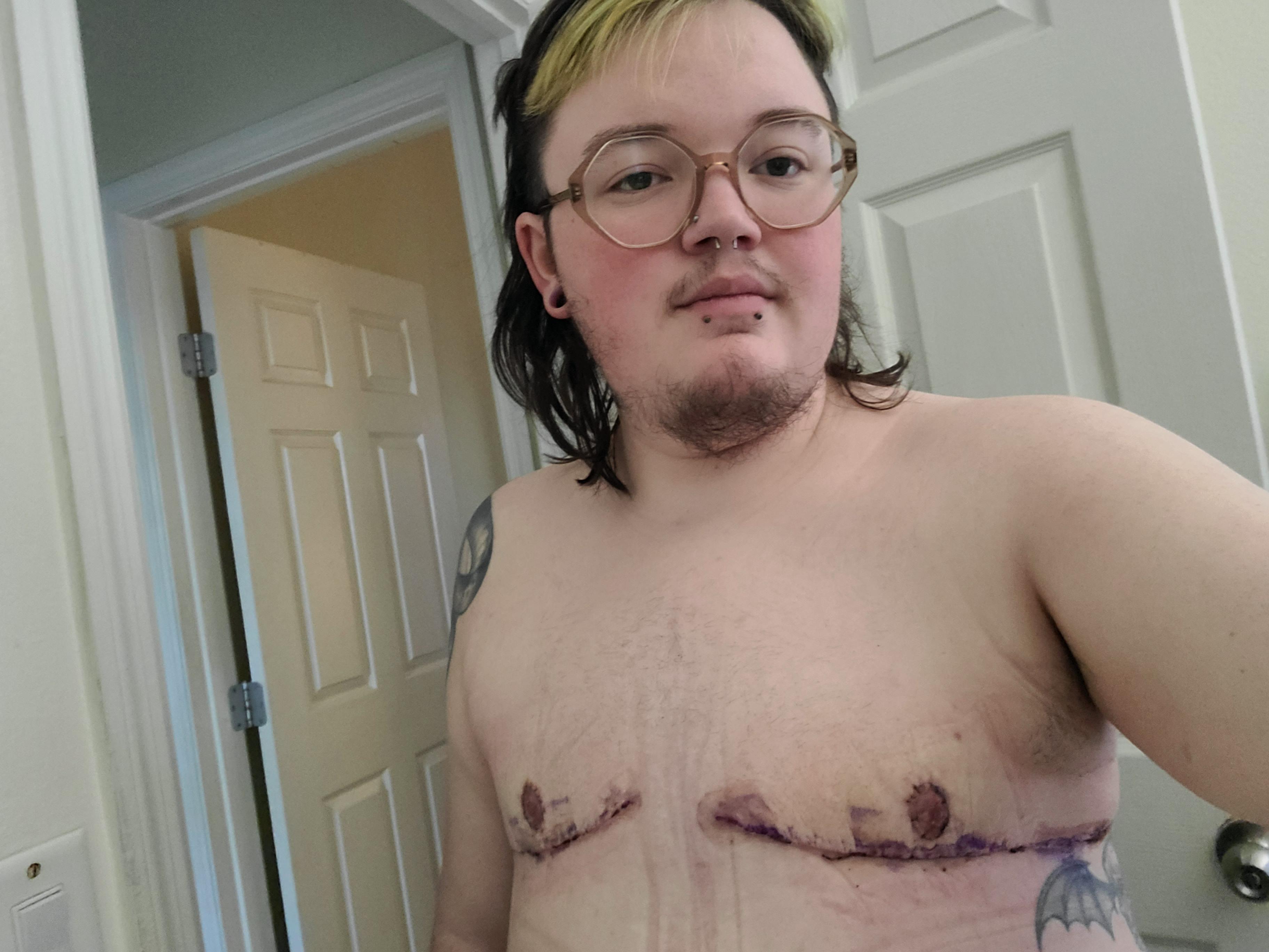 3 weeks post op 🥳 | Scrolller