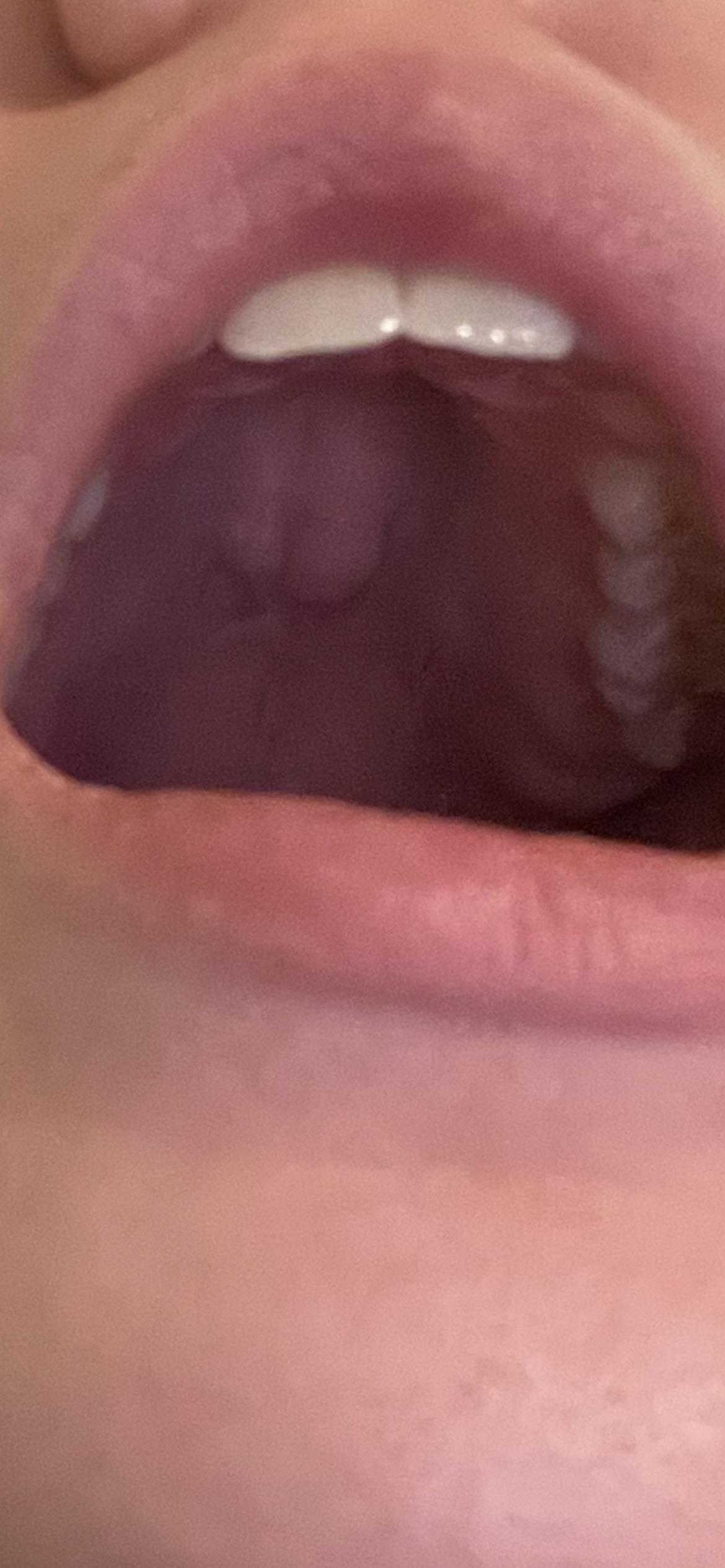 Tori removal? | Scrolller