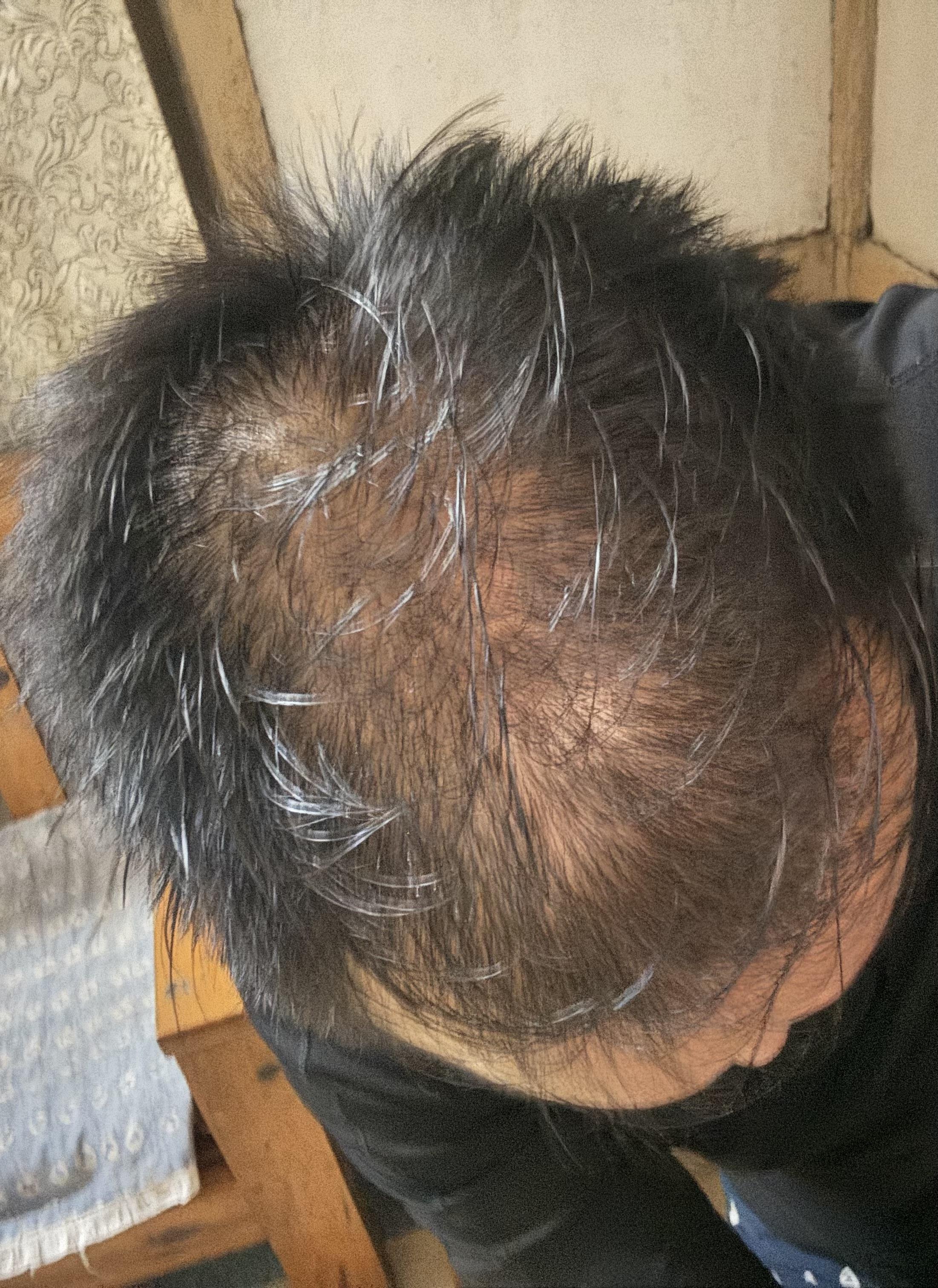 Almost 3 months topical minox before and after | Scrolller