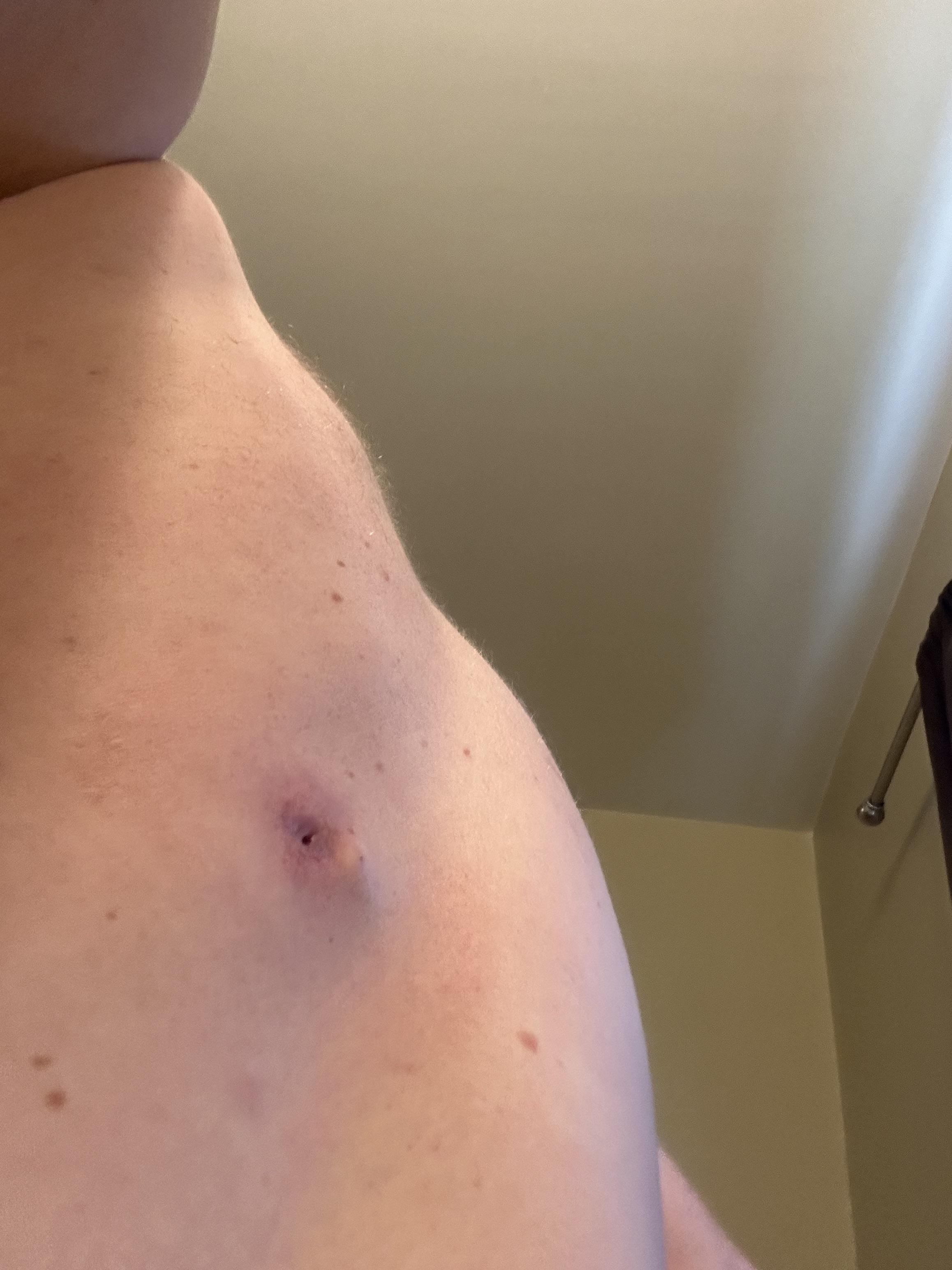 Infected Sebaceous Cyst and Removal | Scrolller