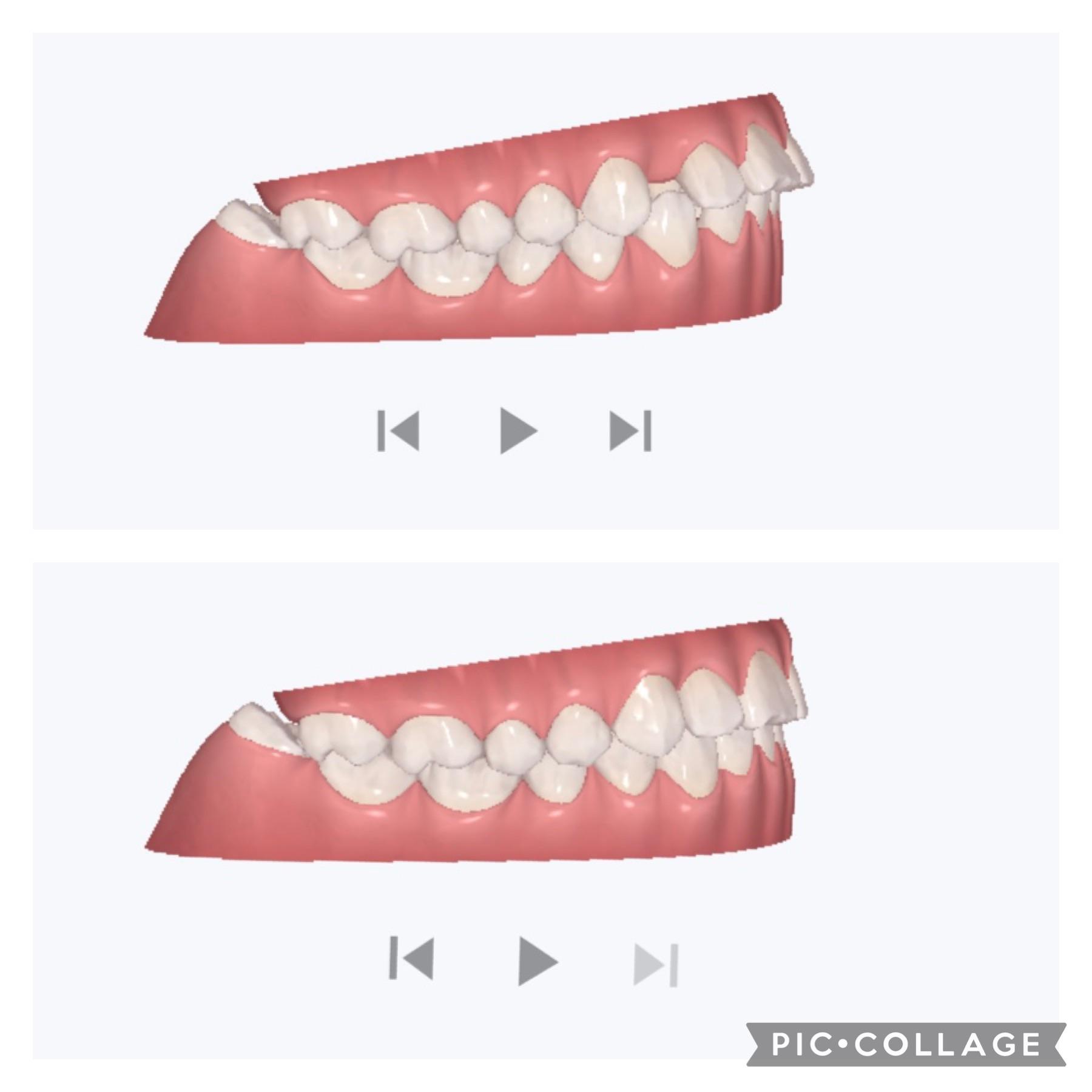 ClinCheck Plan | Scrolller