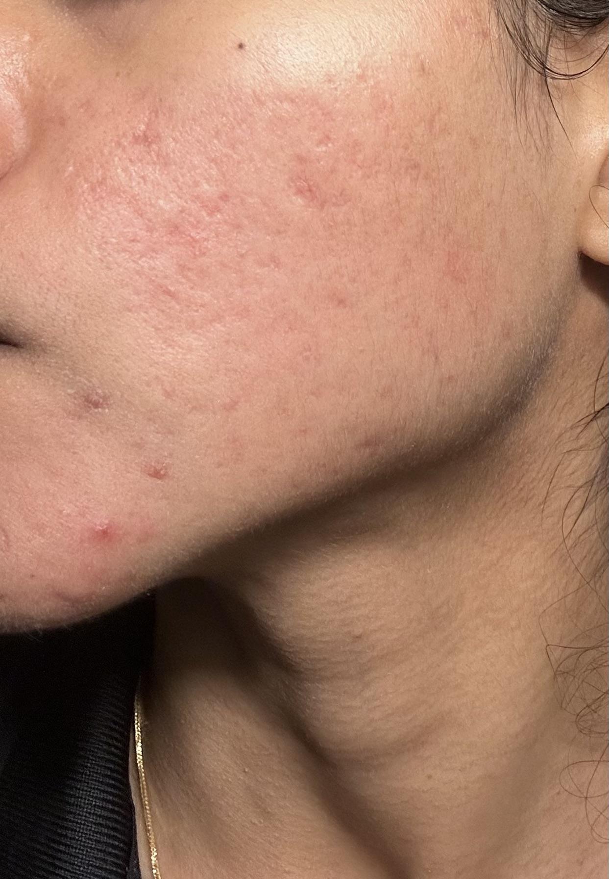 Tretinoin doesn’t keep my skin clear | Scrolller