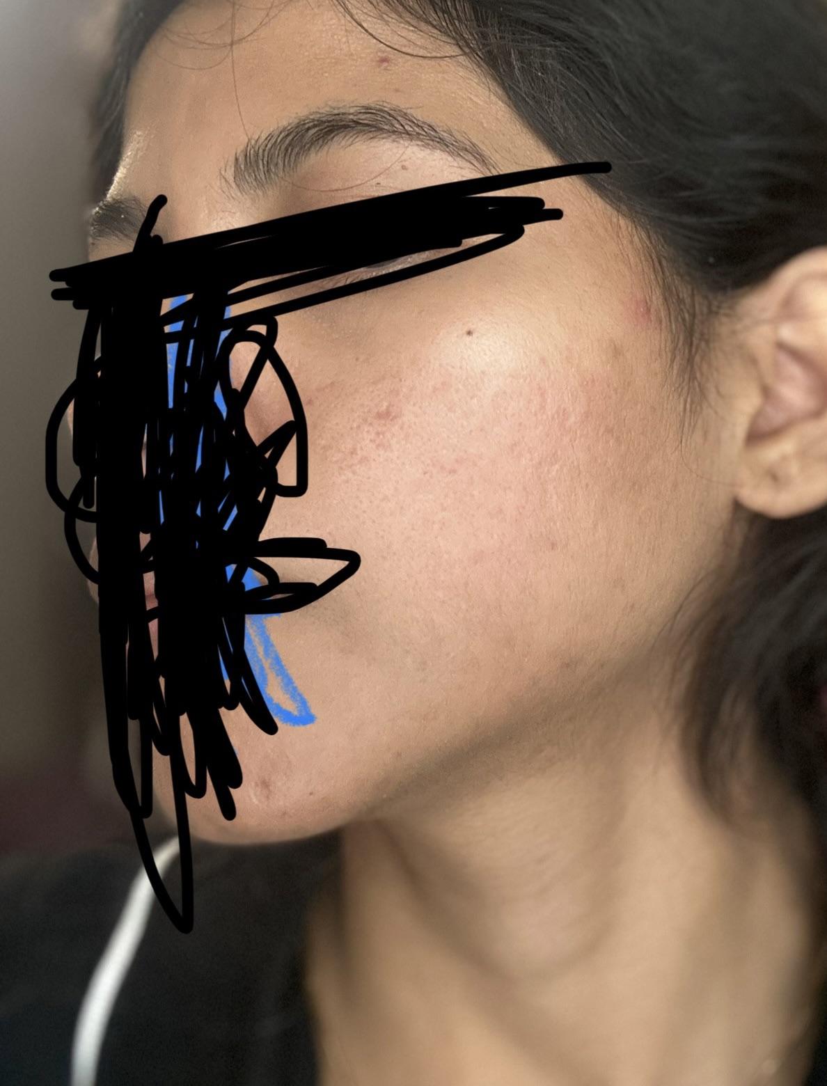 Tretinoin doesn’t keep my skin clear | Scrolller