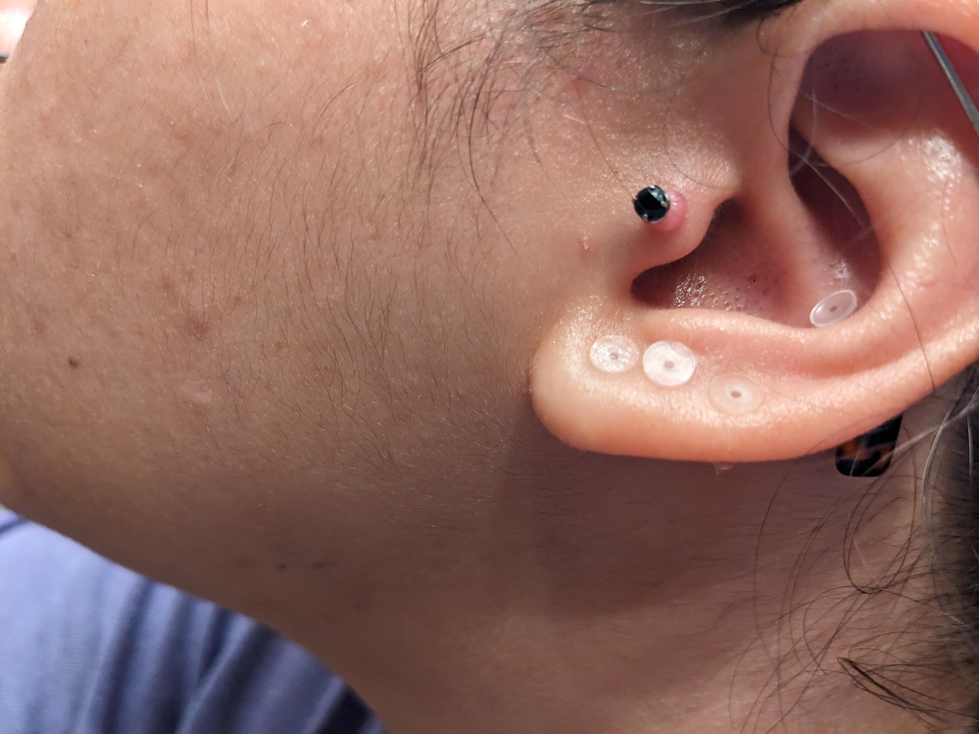 Help! Piercing bump? | Scrolller