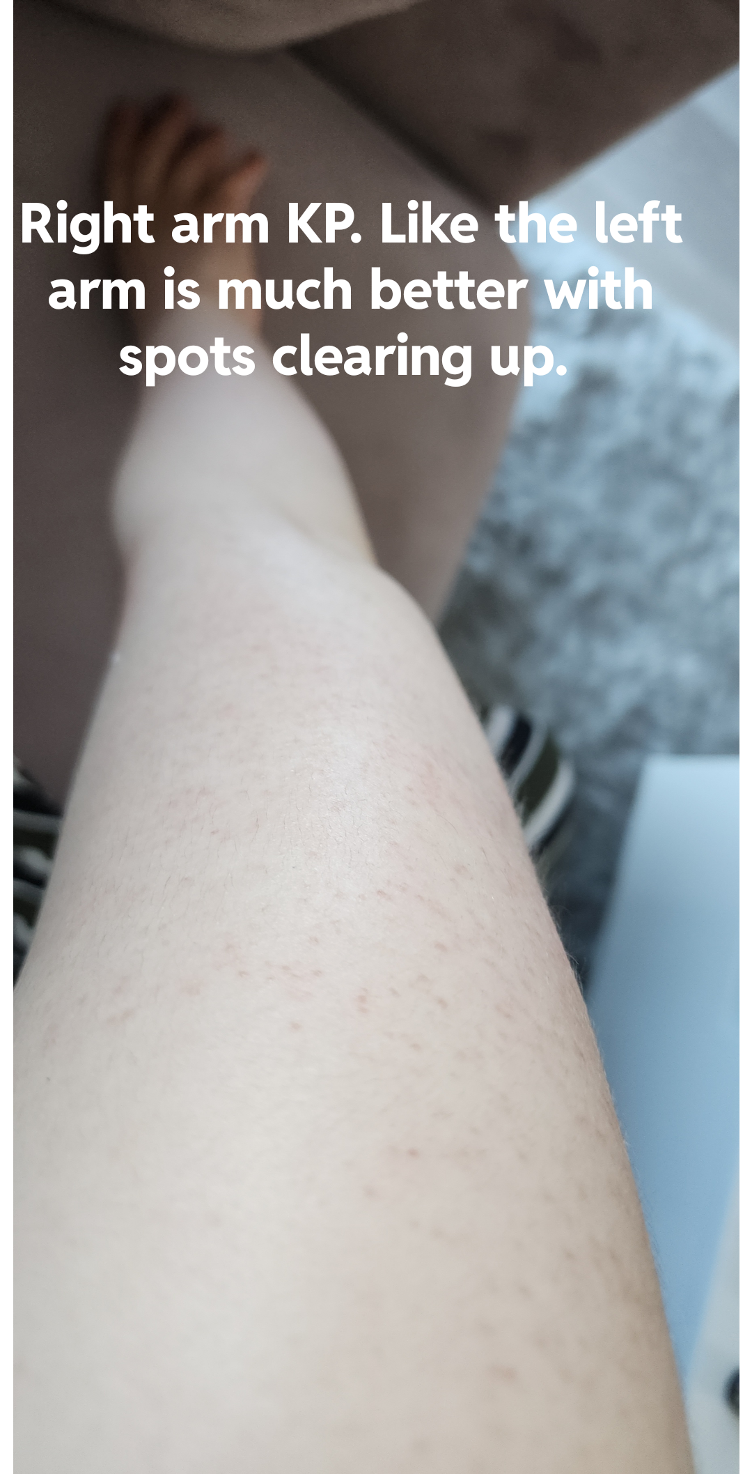 Atopic dermatitis? on skin between forearm and bicep. | Scrolller