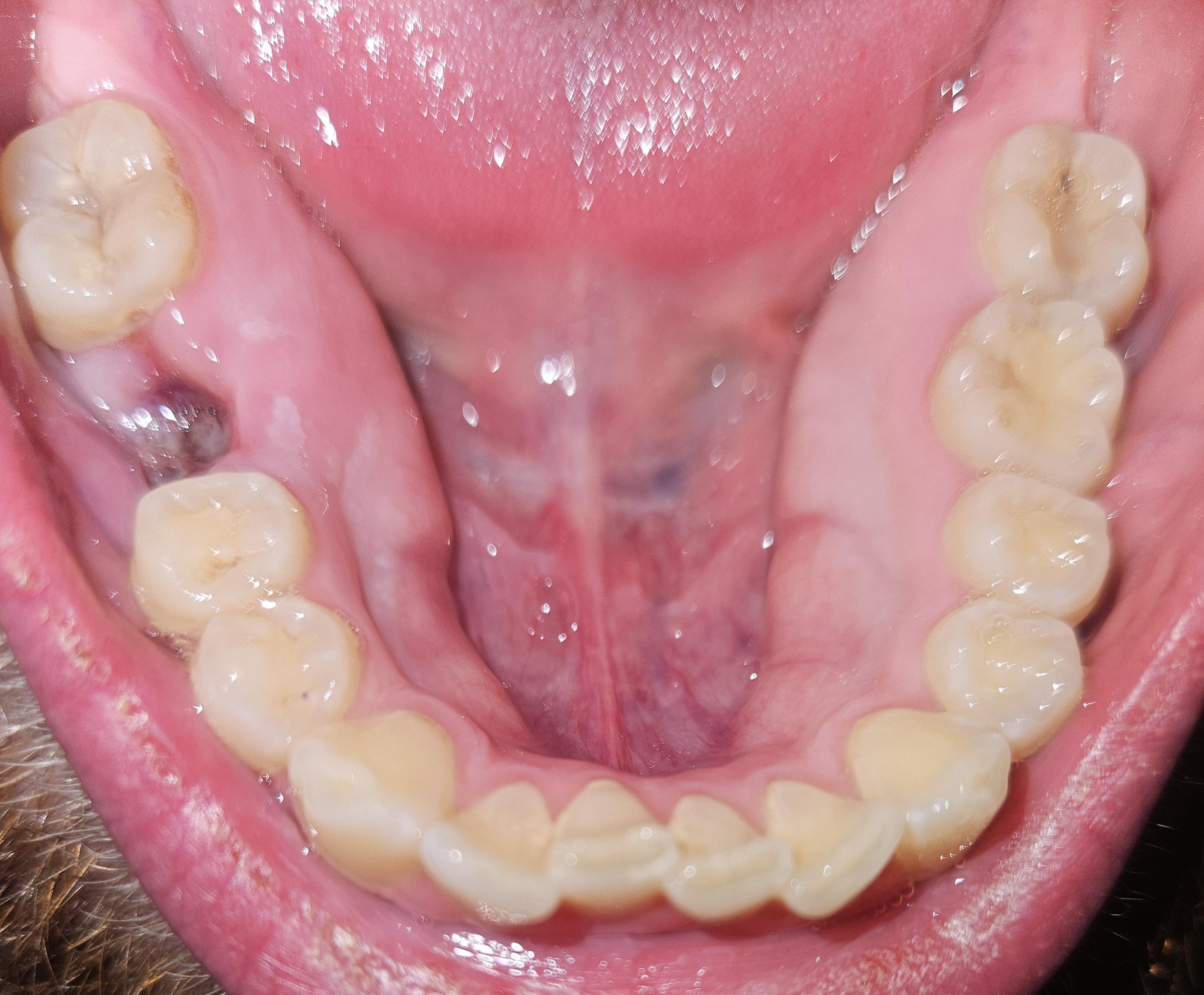 Dry socket?? | Scrolller