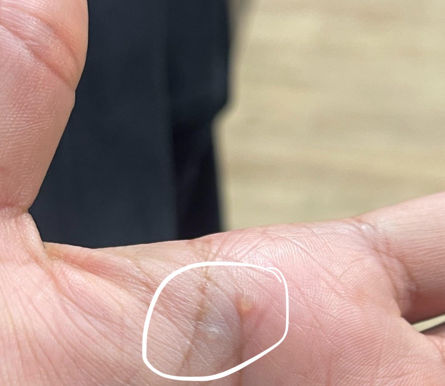 Weird lumps on palm that look like blisters | Scrolller