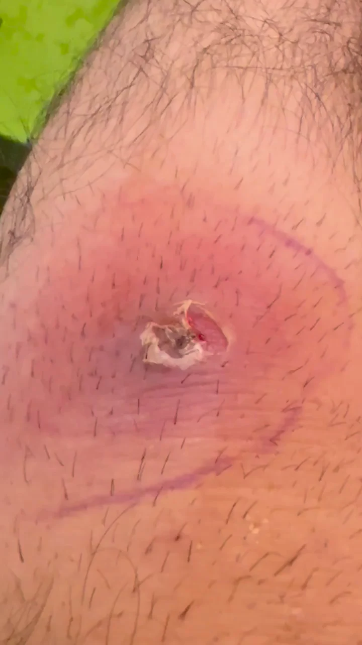 Infected insect bite on the leg. 11 days post bite. | Scrolller