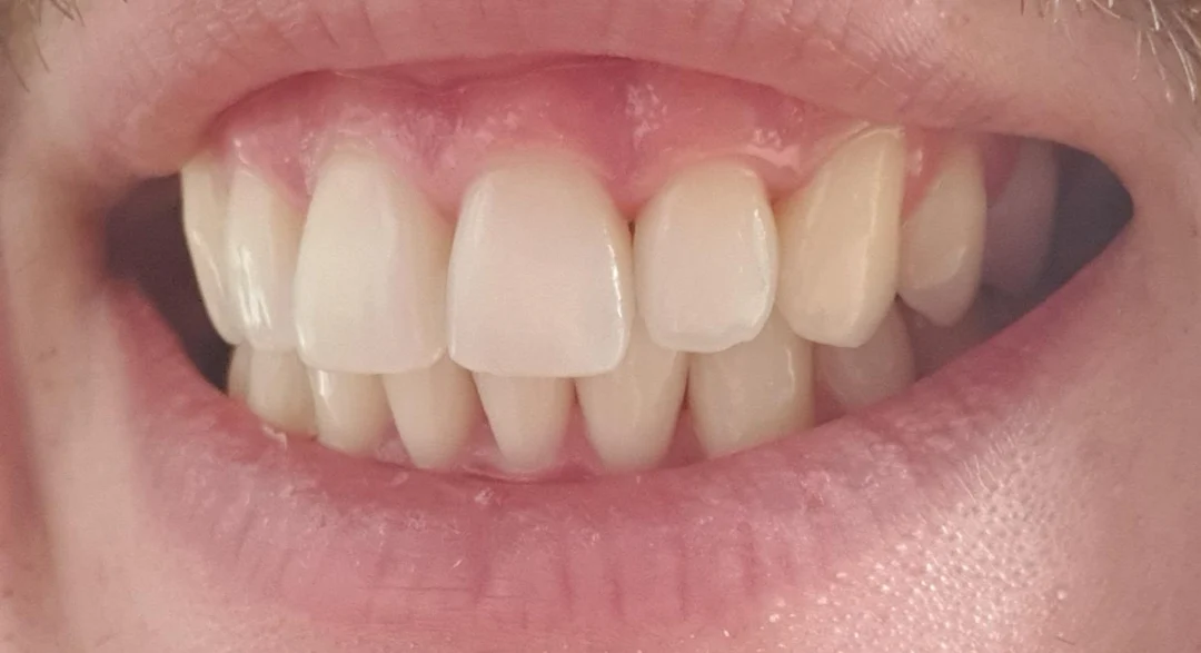 Braces Came Off Scrolller