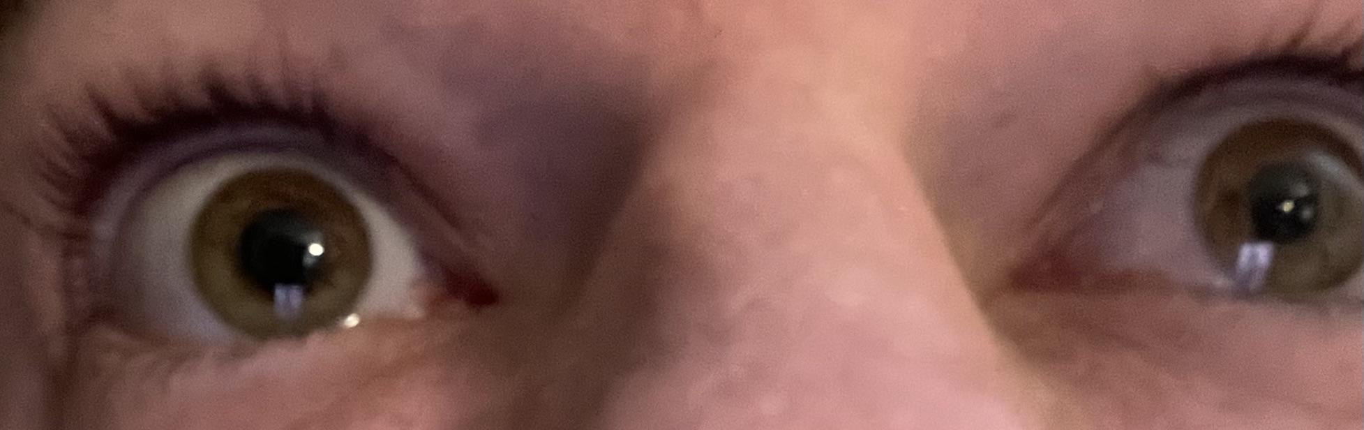 Pupil size difference | Scrolller