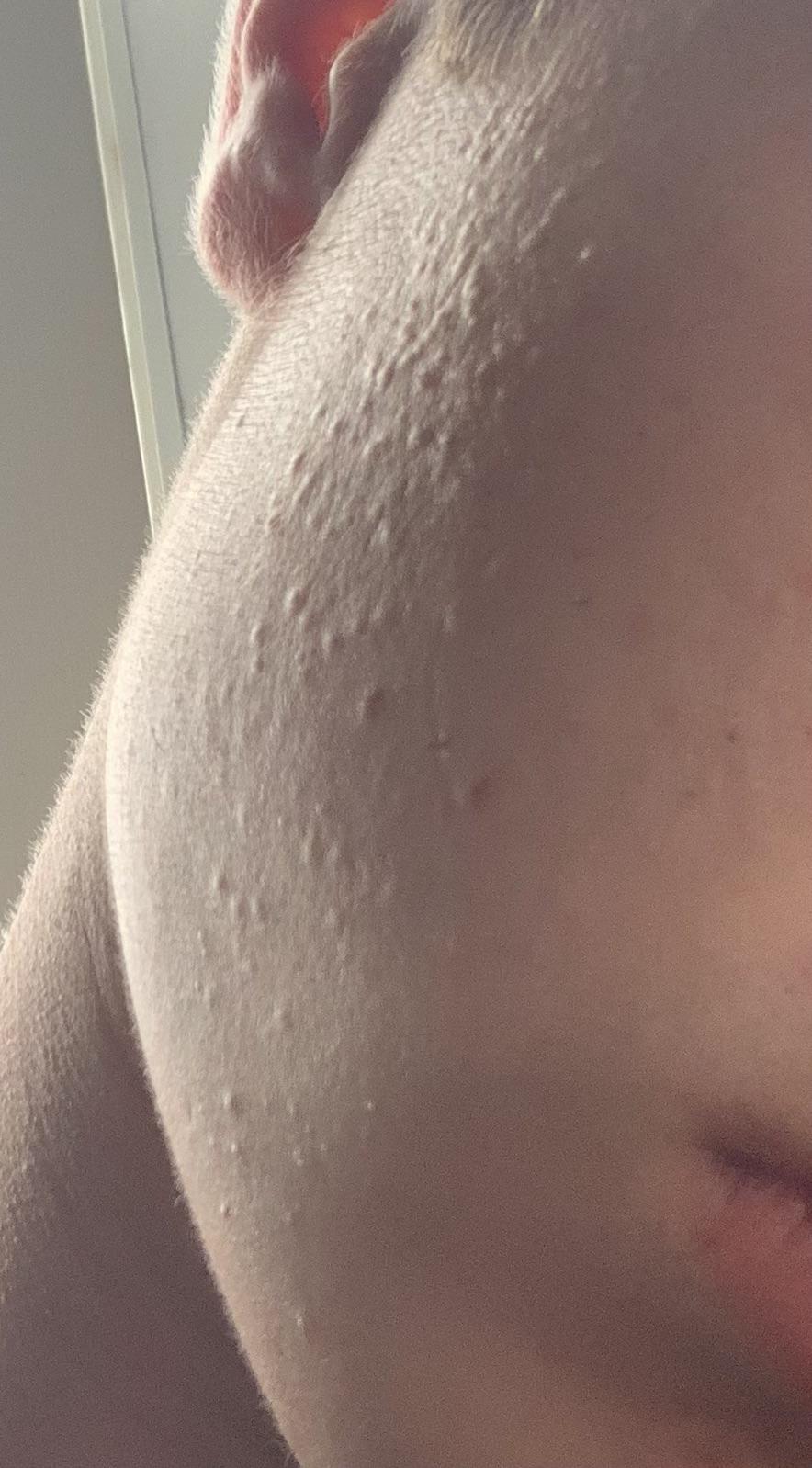 Acne bumps | Scrolller