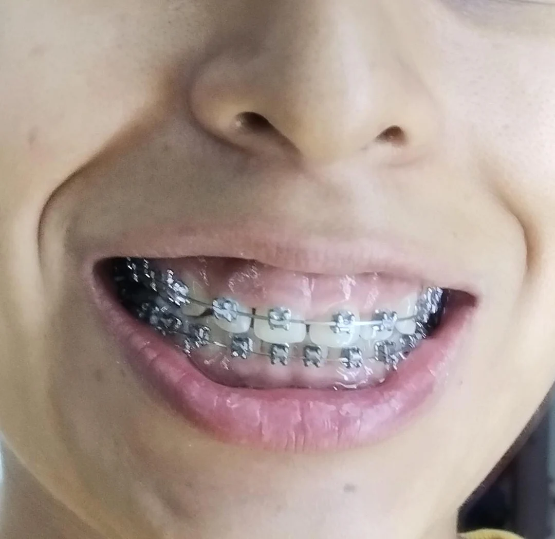 First day with two rows of braces! | Scrolller
