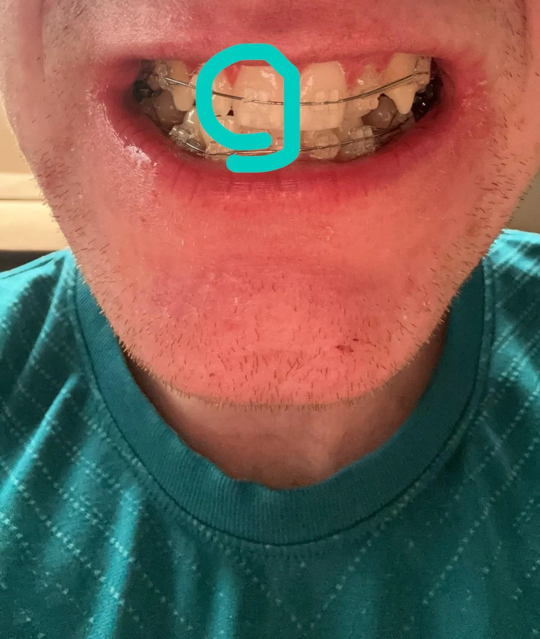 Rubber band looked loose and was trying to put it back behind tooth it came off and we’ve put it ...