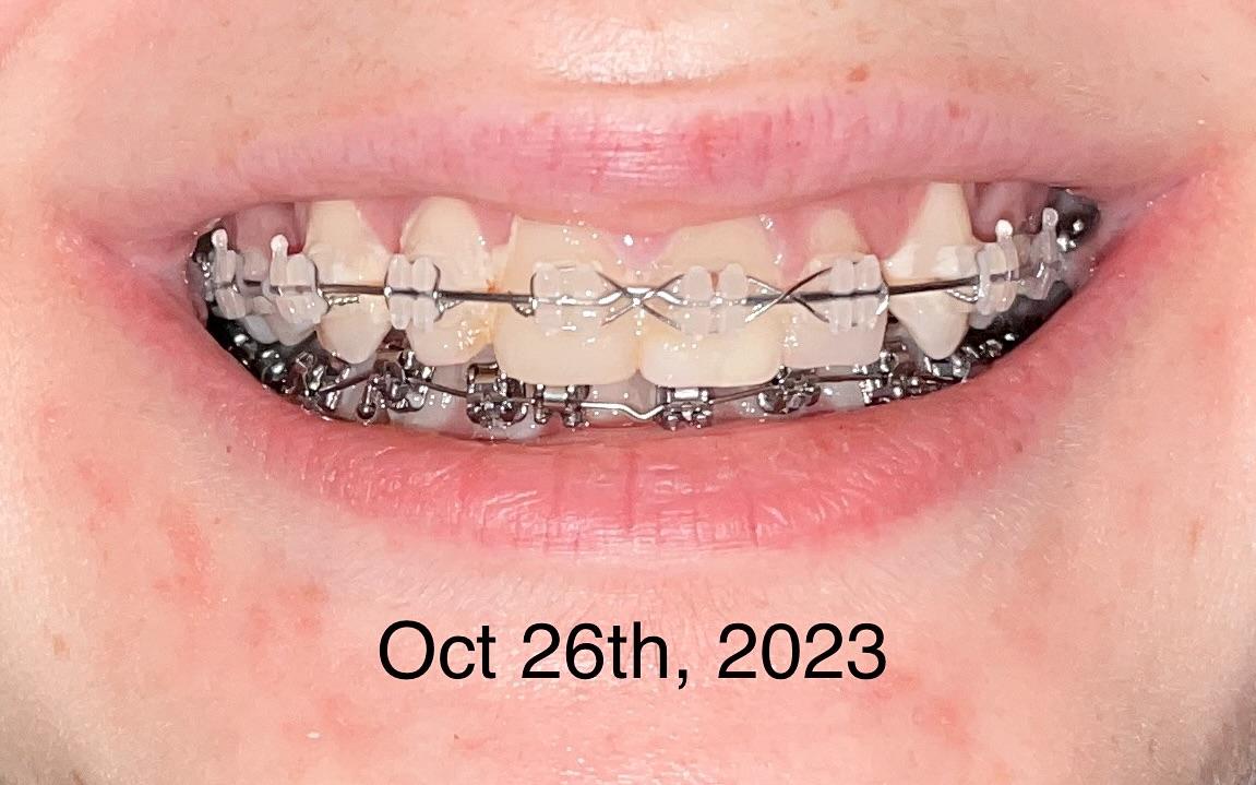 Braces 5 Month Progress Scrolller
