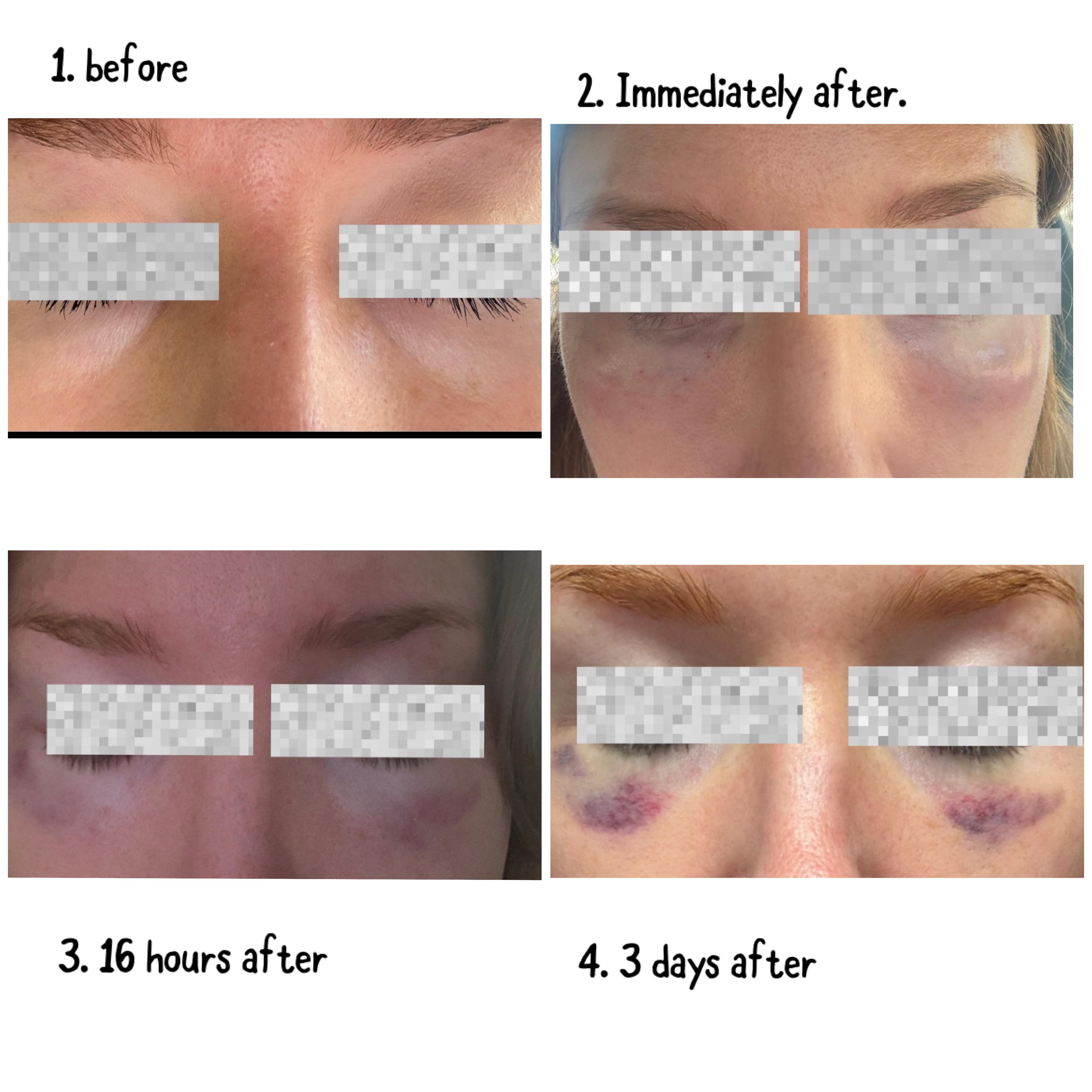 PRP Under Eye Injections | Scrolller