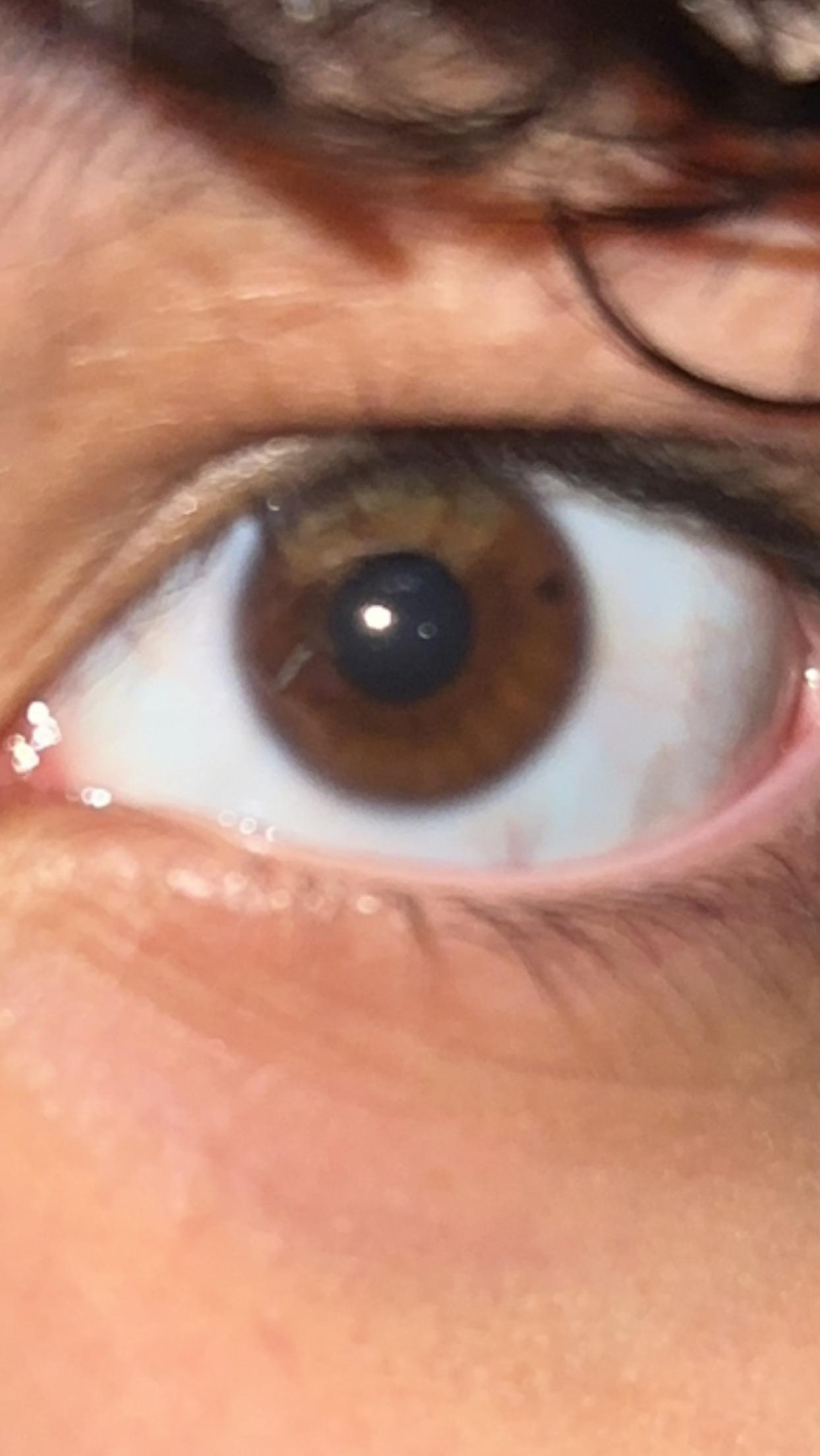 What is this think in my iris? | Scrolller