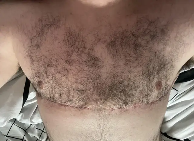 14 weeks post OP | Scrolller