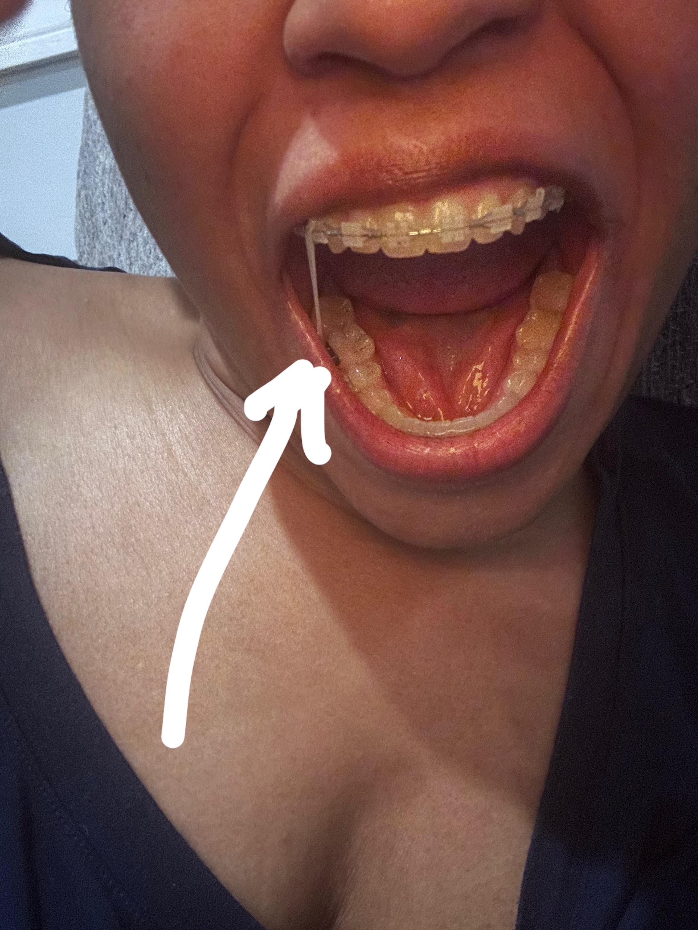 Back tooth sorta loose and sensitive. | Scrolller