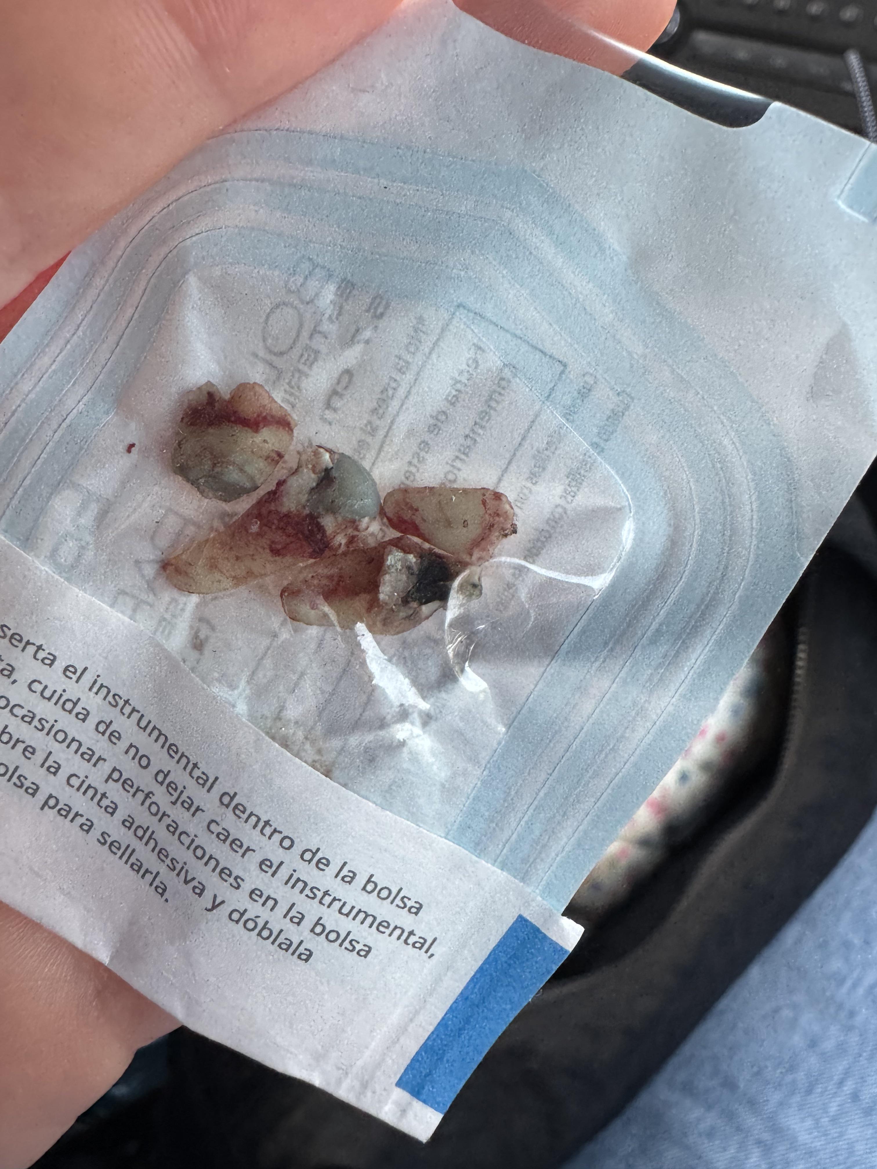 Tooth extracted | Scrolller