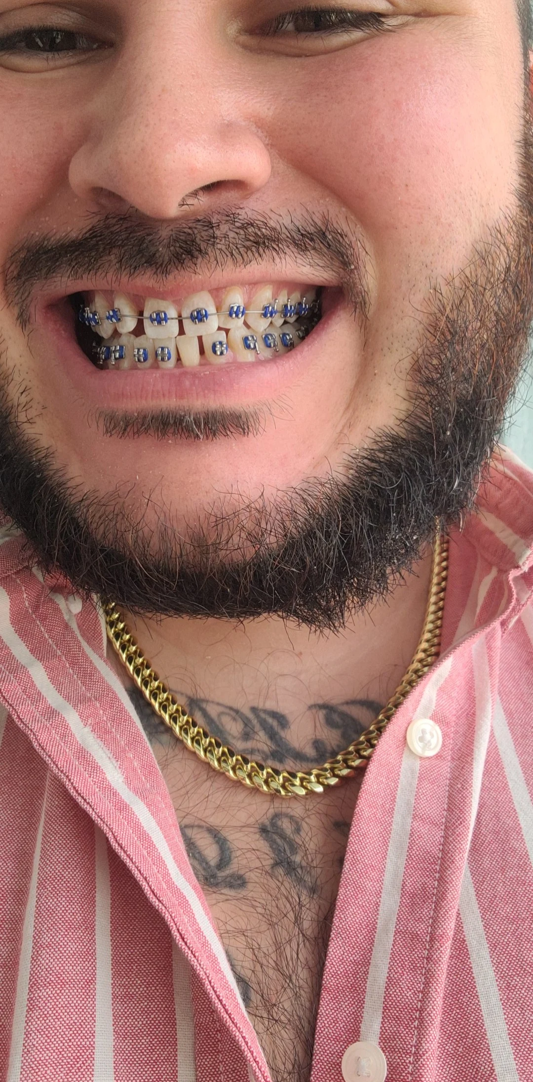 got my braces on today! pulling the tooth next week that's missing the bracket. | Scrolller