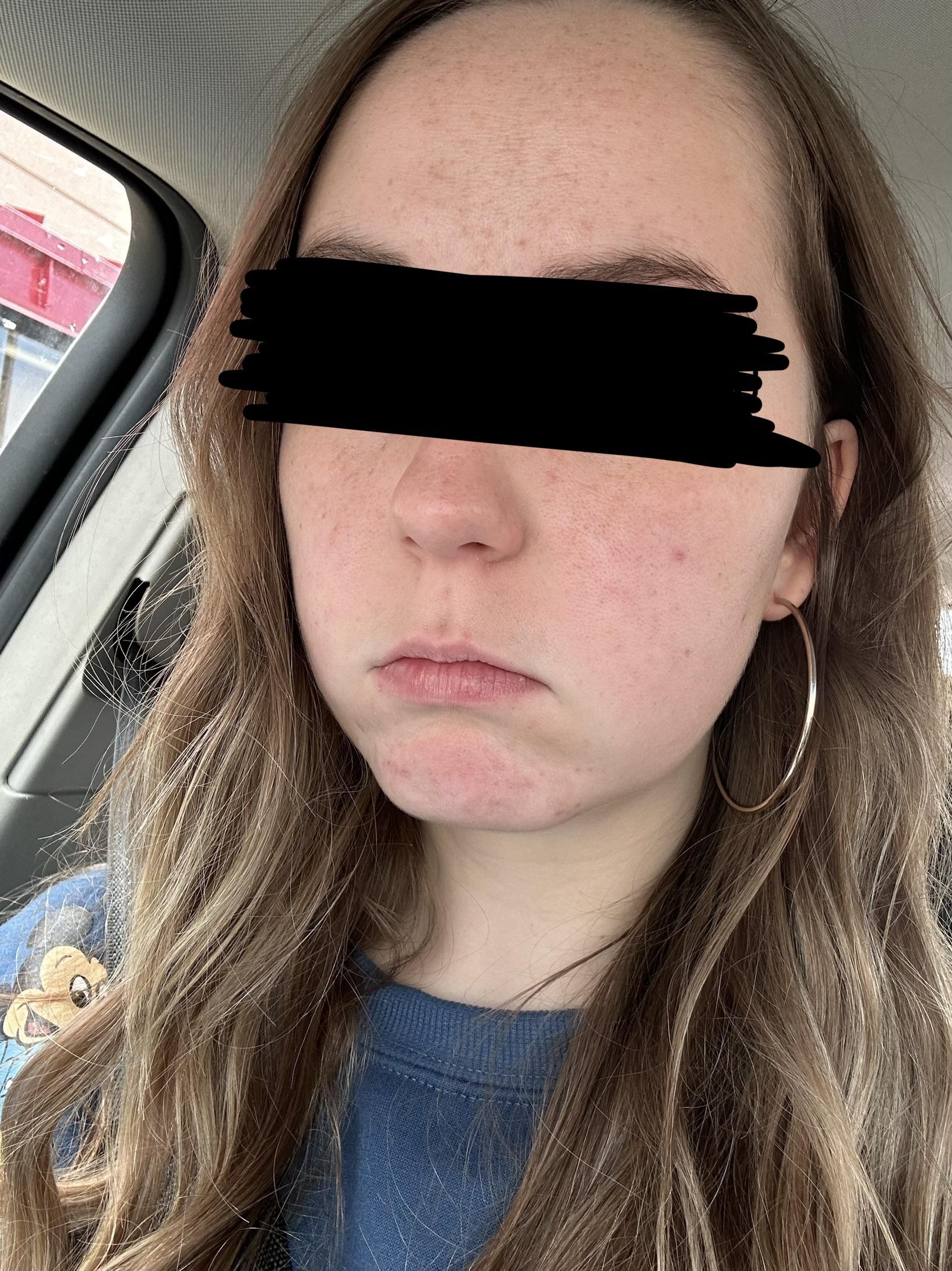 Redness & Spots | Scrolller