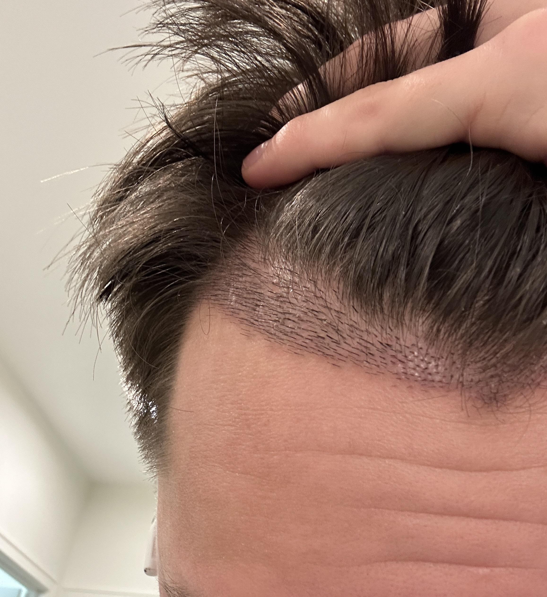 Hair texture after transplant | Scrolller